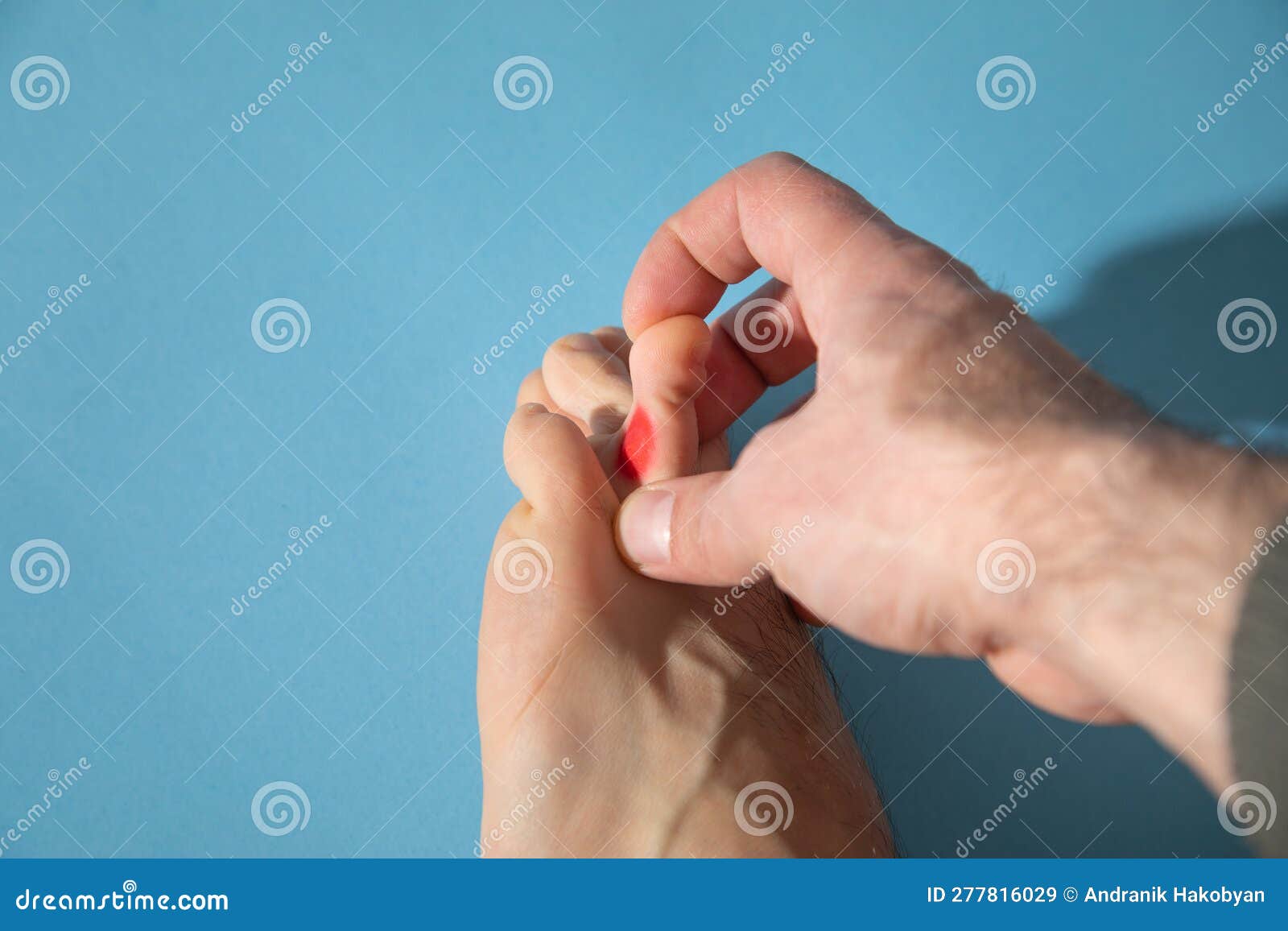 Callus on the Foot. Skin Problems Stock Image - Image of clavus ...