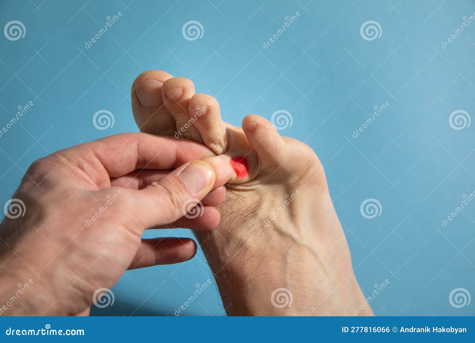 Callus on the Foot. Skin Problems Stock Photo - Image of barefoot ...