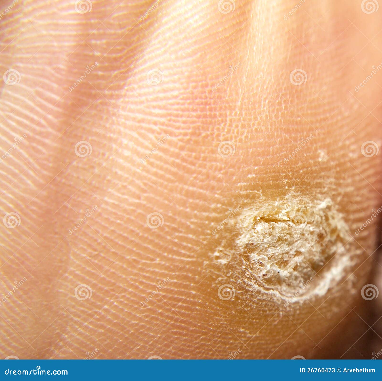 Callus And Hyperkeratosis Stock Photo | CartoonDealer.com #26760396