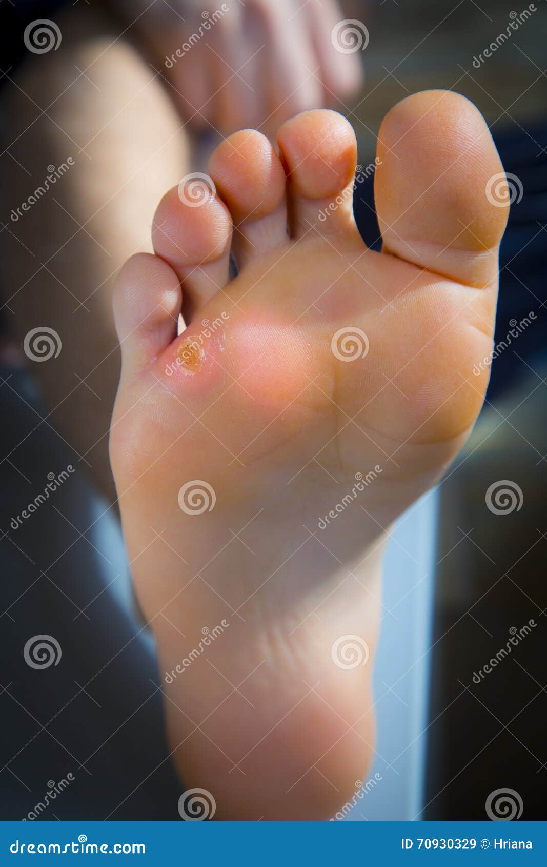 Calluses on foot stock image. Image of hygiene, healthcare - 70930329