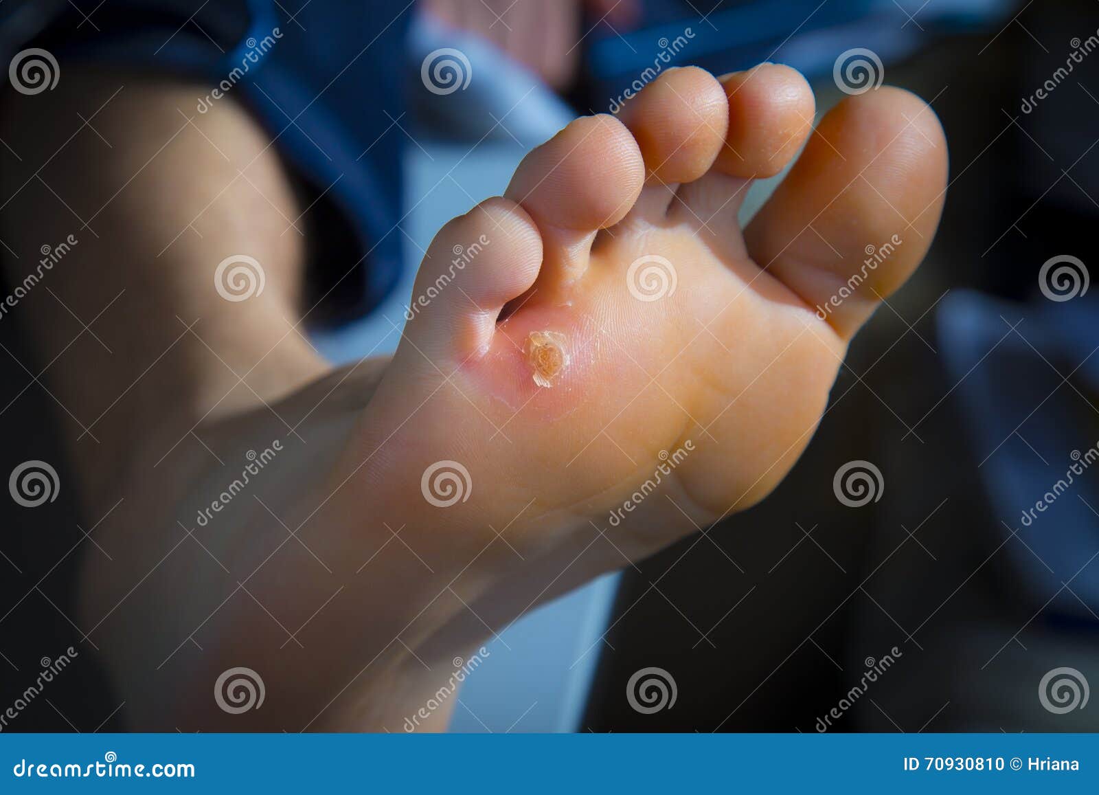 Calluses on foot stock photo. Image of care, callus, toes - 70930810