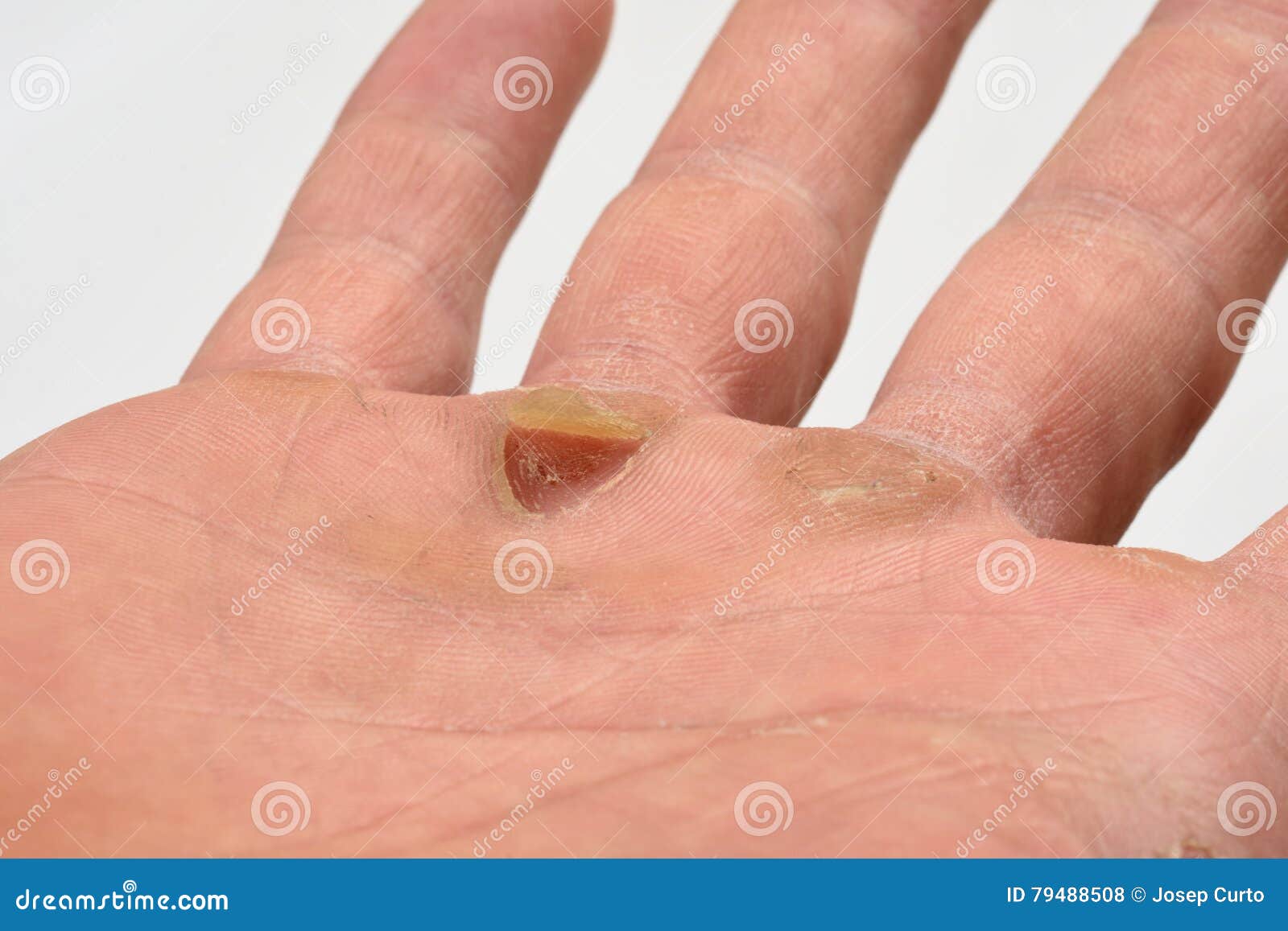 Calluses on the palm, stock photo. Image of hands, body - 79488508