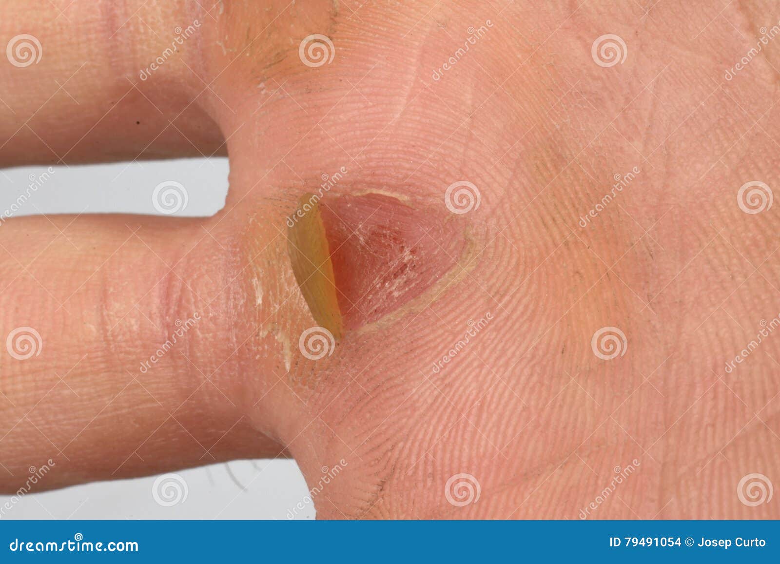 Calluses on the palm, stock photo. Image of human, macro - 79491054