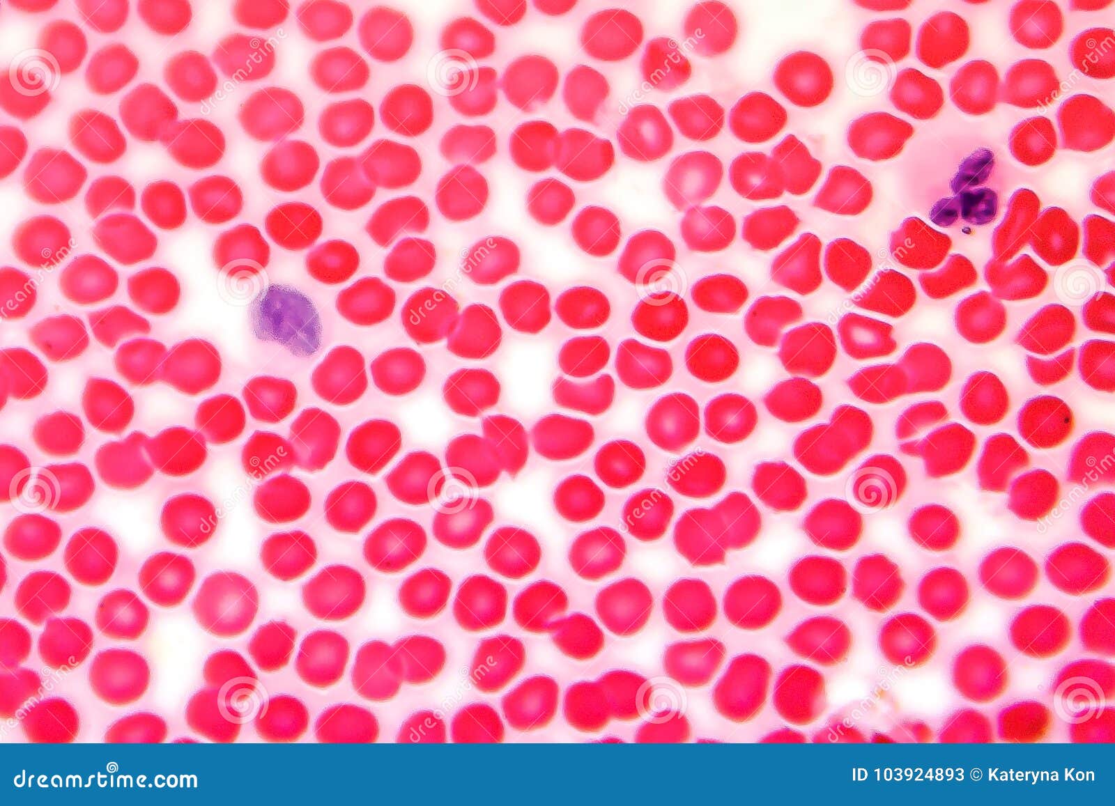 Calomnie De Sang Humain Sous Le Microscope Image stock - Image du ...