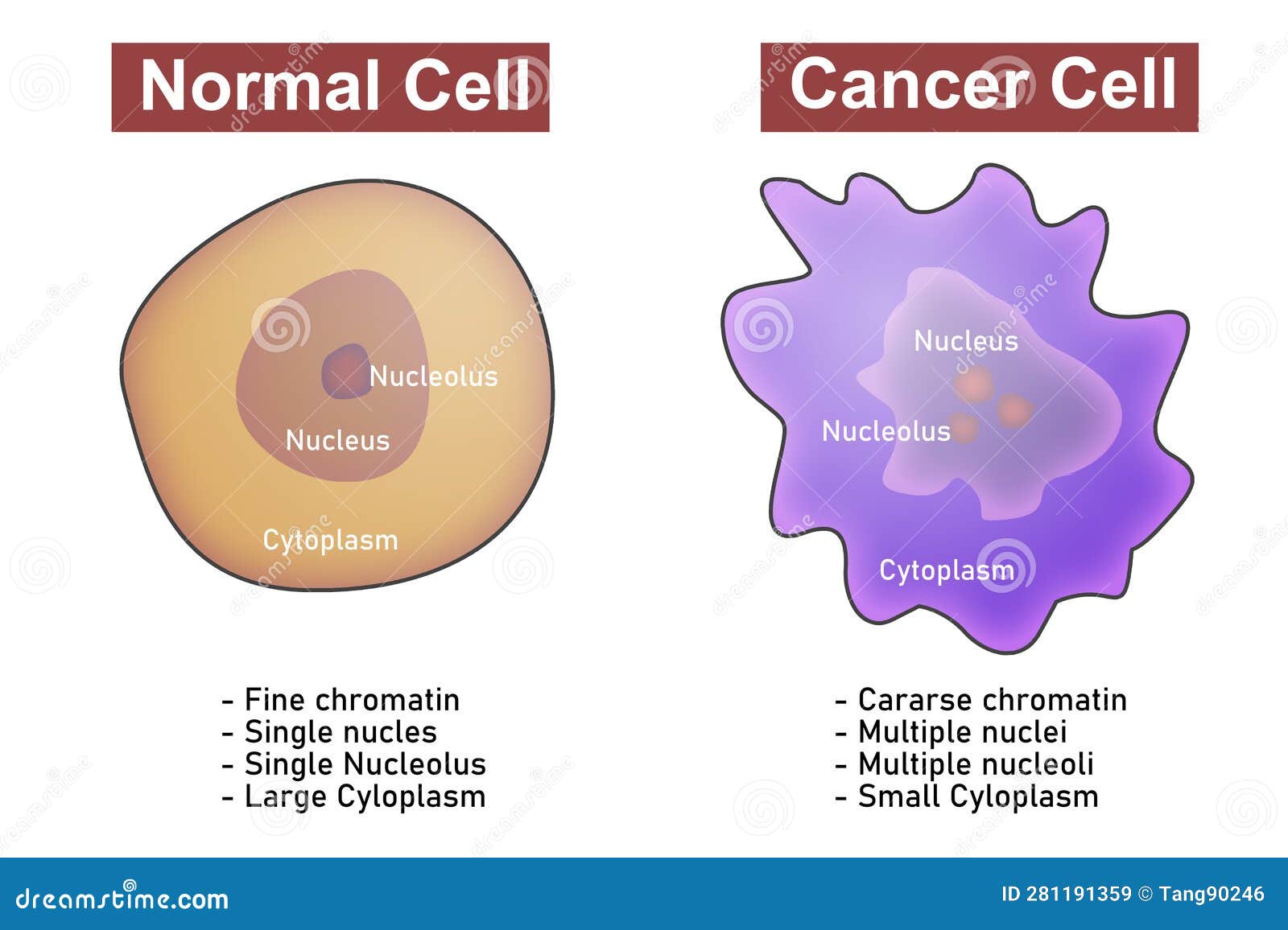 Cancer Cell Stage and Development before after Stock Illustration ...