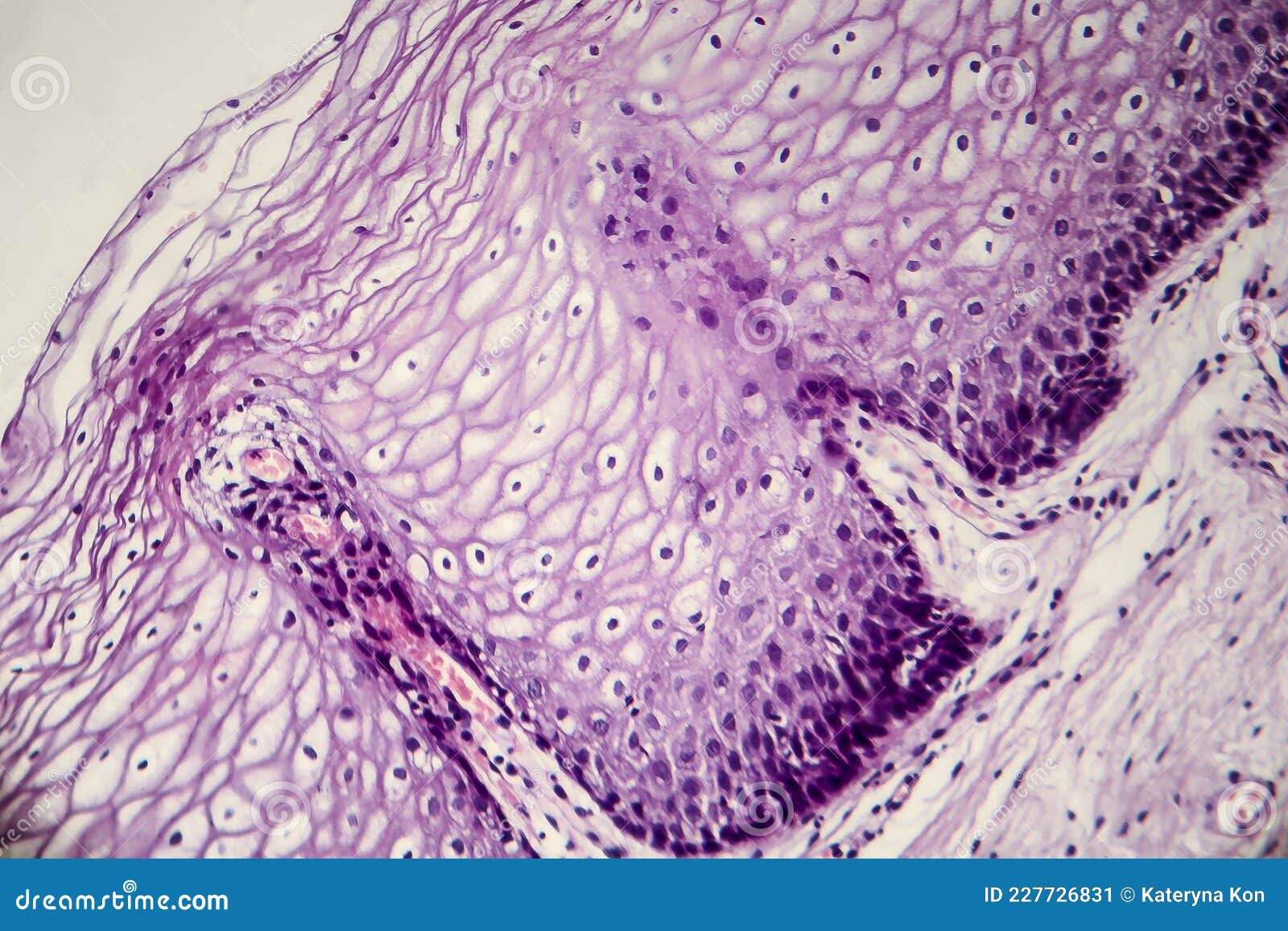 Cancer of Cervix. Light Micrograph of Cervical Biopsy Stock Image ...