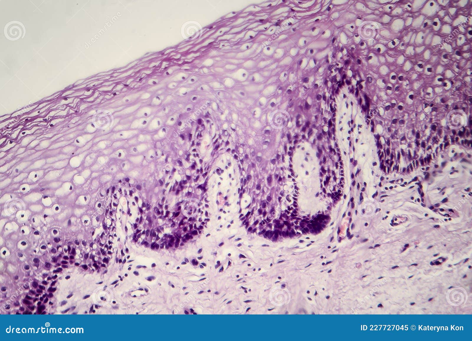 Cancer of Cervix. Light Micrograph of Cervical Biopsy Stock Image ...