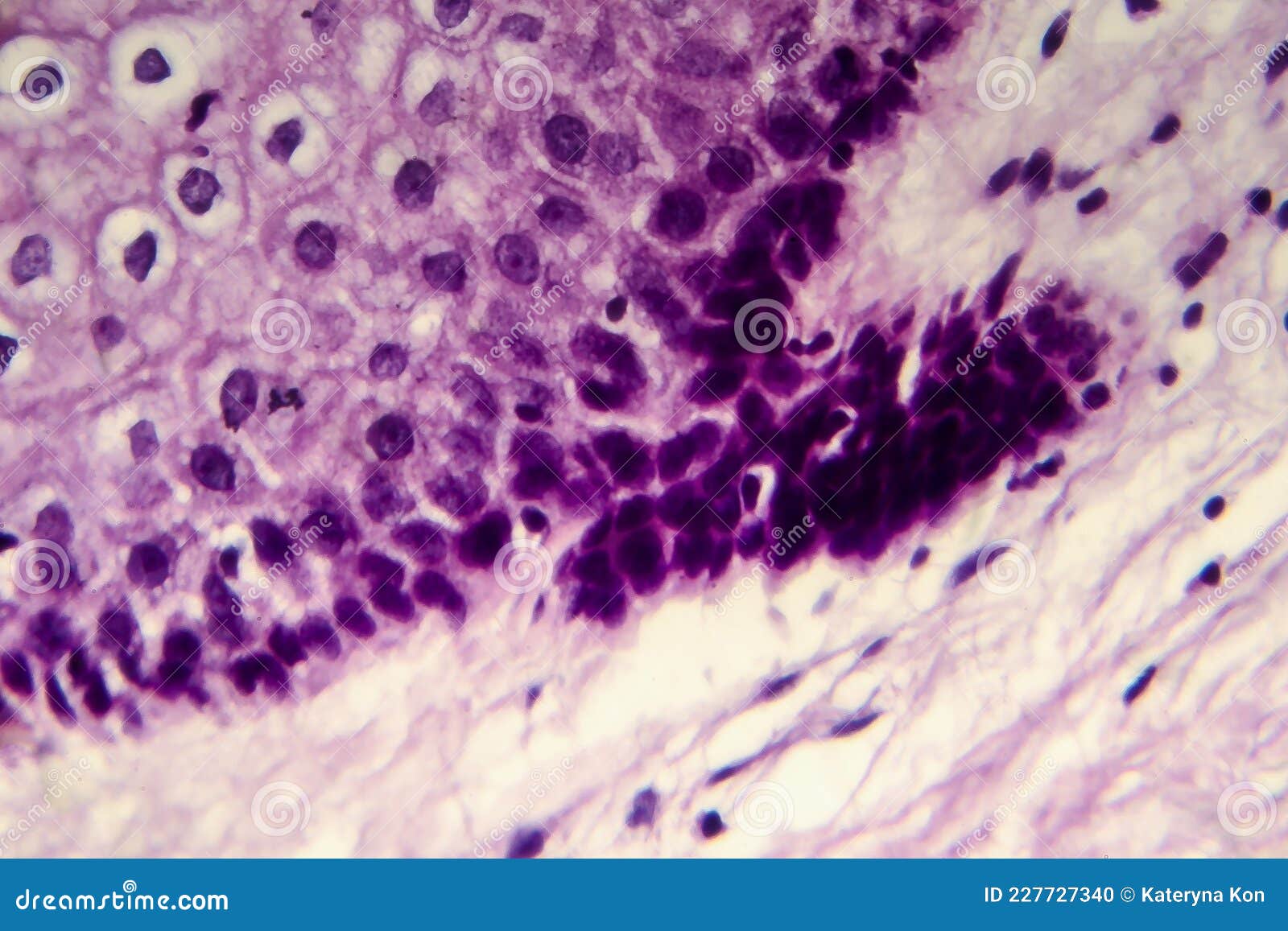 Cancer Of Cervix. Light Micrograph Of Cervical Biopsy. Photo Under ...