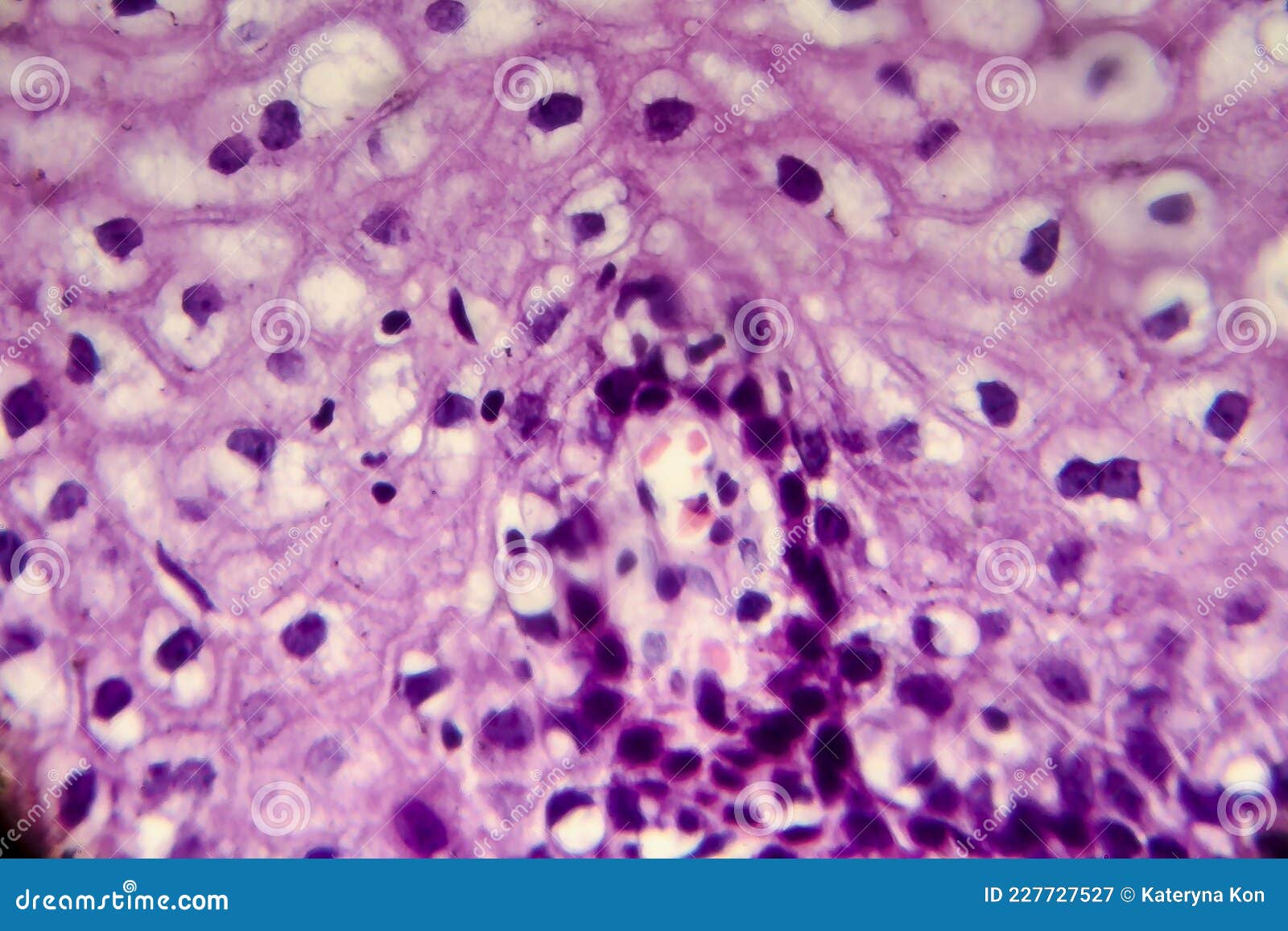 Cancer of Cervix. Light Micrograph of Cervical Biopsy Stock Image ...