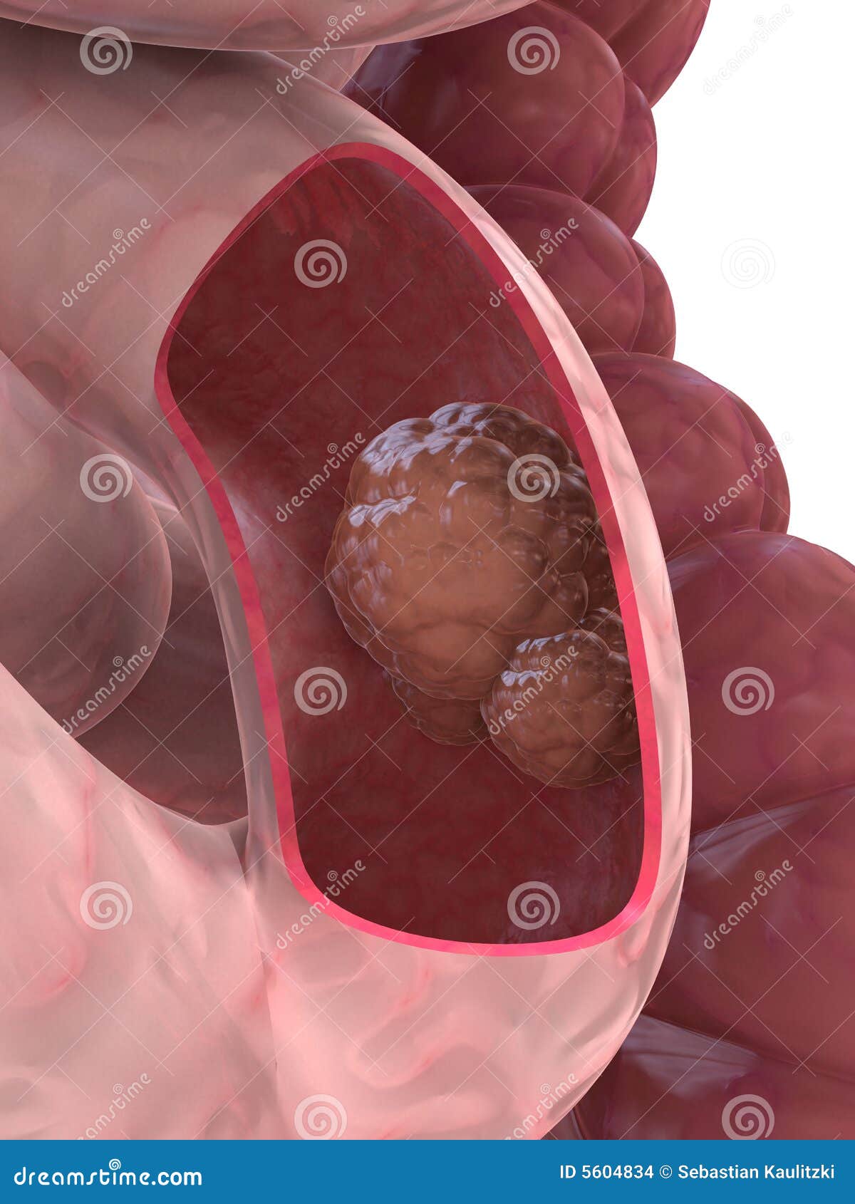 Cancer Dans Le Petit Intestin Illustration Stock - Illustration du ...