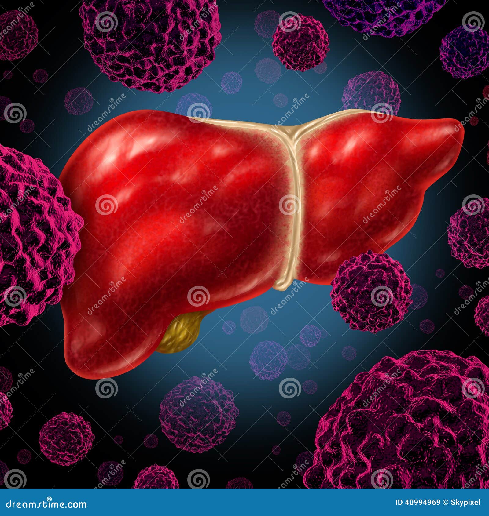 Cancer de foie humain illustration stock. Illustration du médical ...