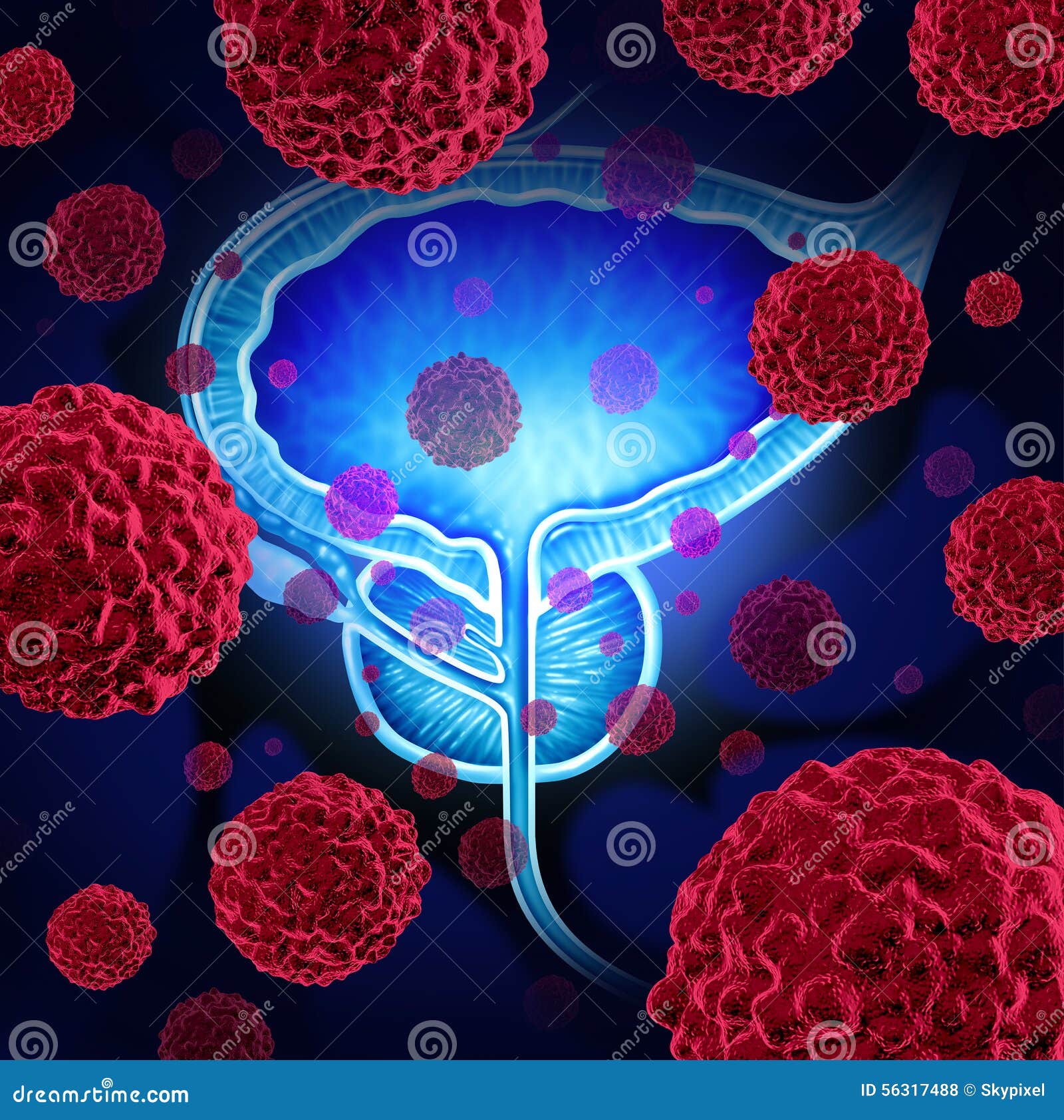 CANCER DE LA PROSTATE illustration stock. Illustration du masculin ...