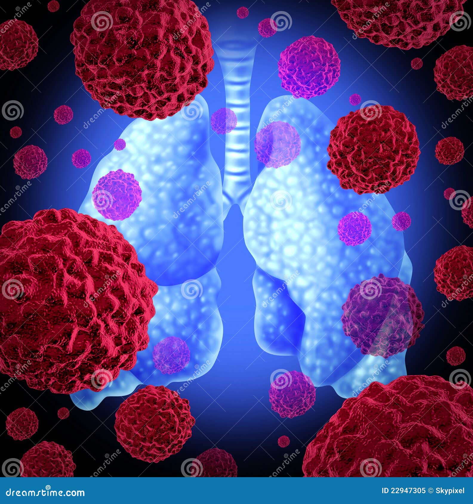Cancer de poumon illustration stock. Illustration of molécules - 22947305