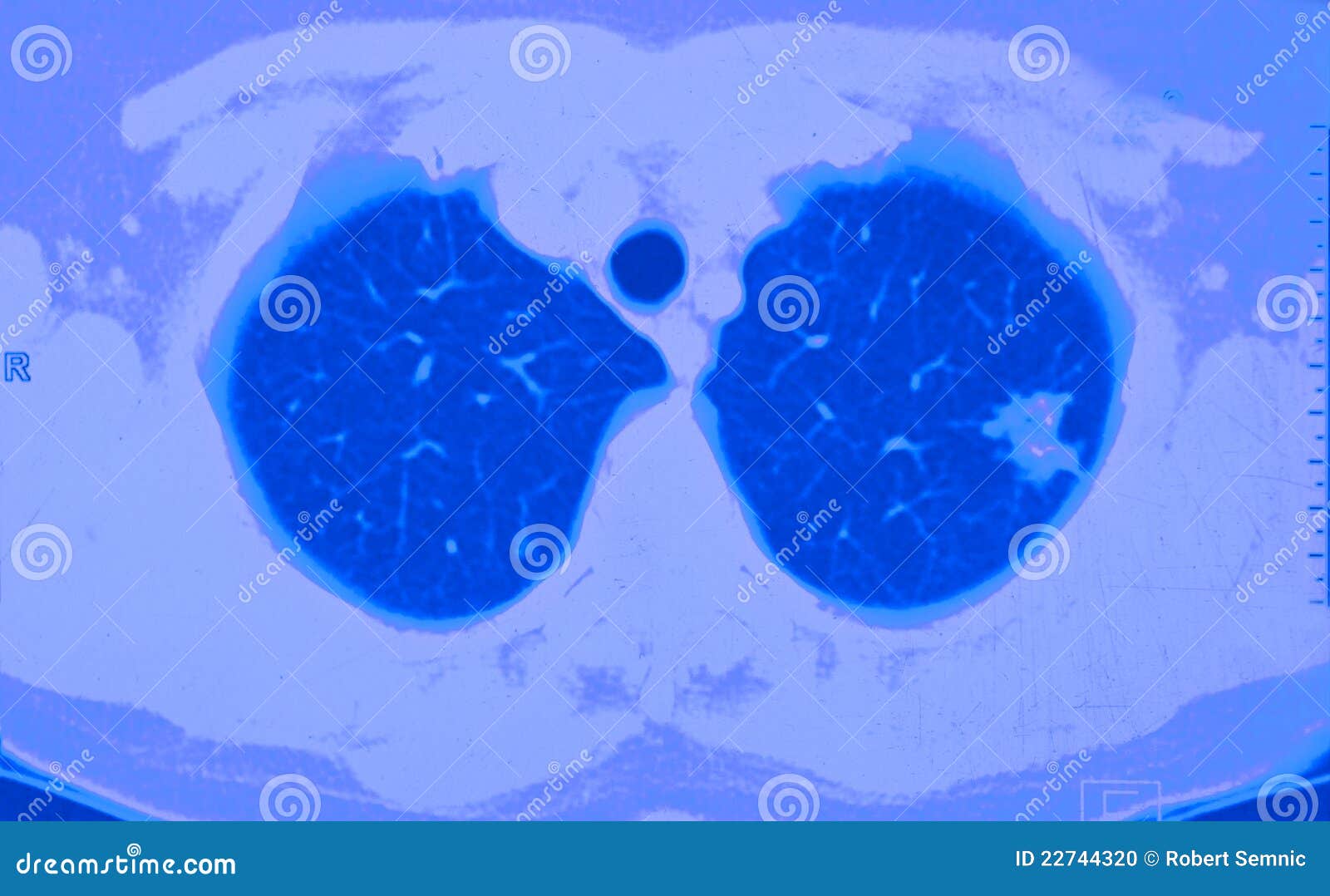 Cancer de poumon CT photo stock. Image du fermer, larve - 22744320