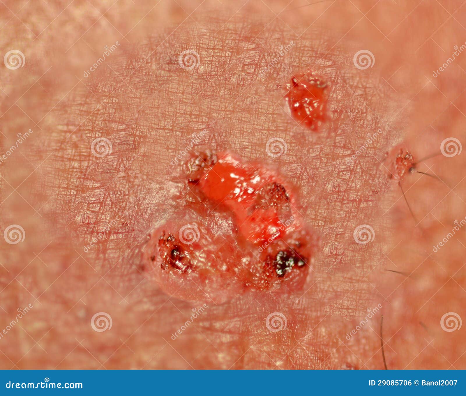 Cancer Of Skin, Ulcerated Lesion Is Close-up. Stock Image ...
