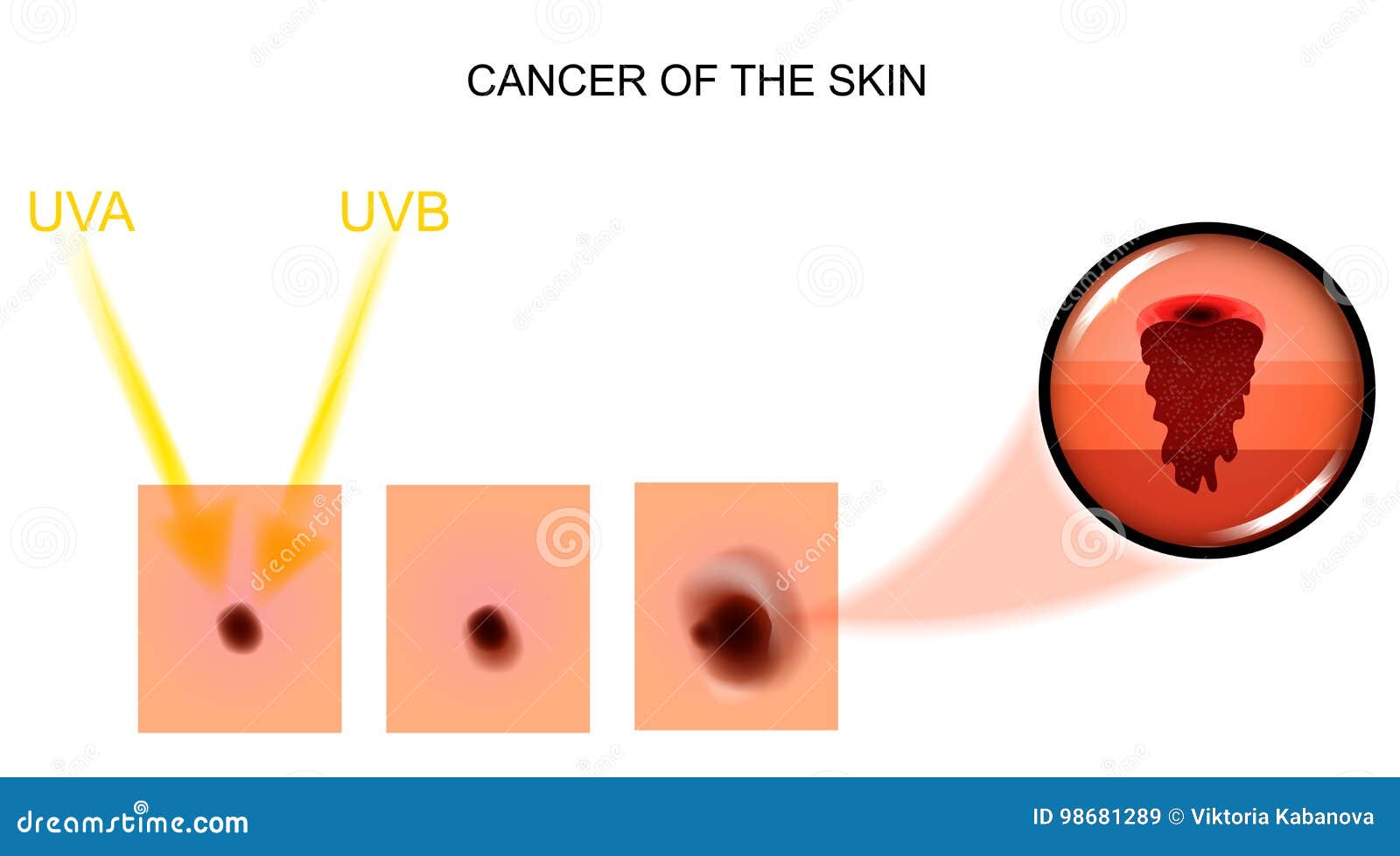 Cancer of the Skin. Oncology Stock Vector - Illustration of macro ...