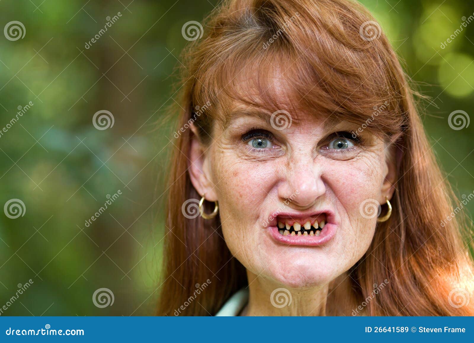 Abnormal Boy Tooth. The Extra Narrow Strange Tooth Grew In The Boy`s ...