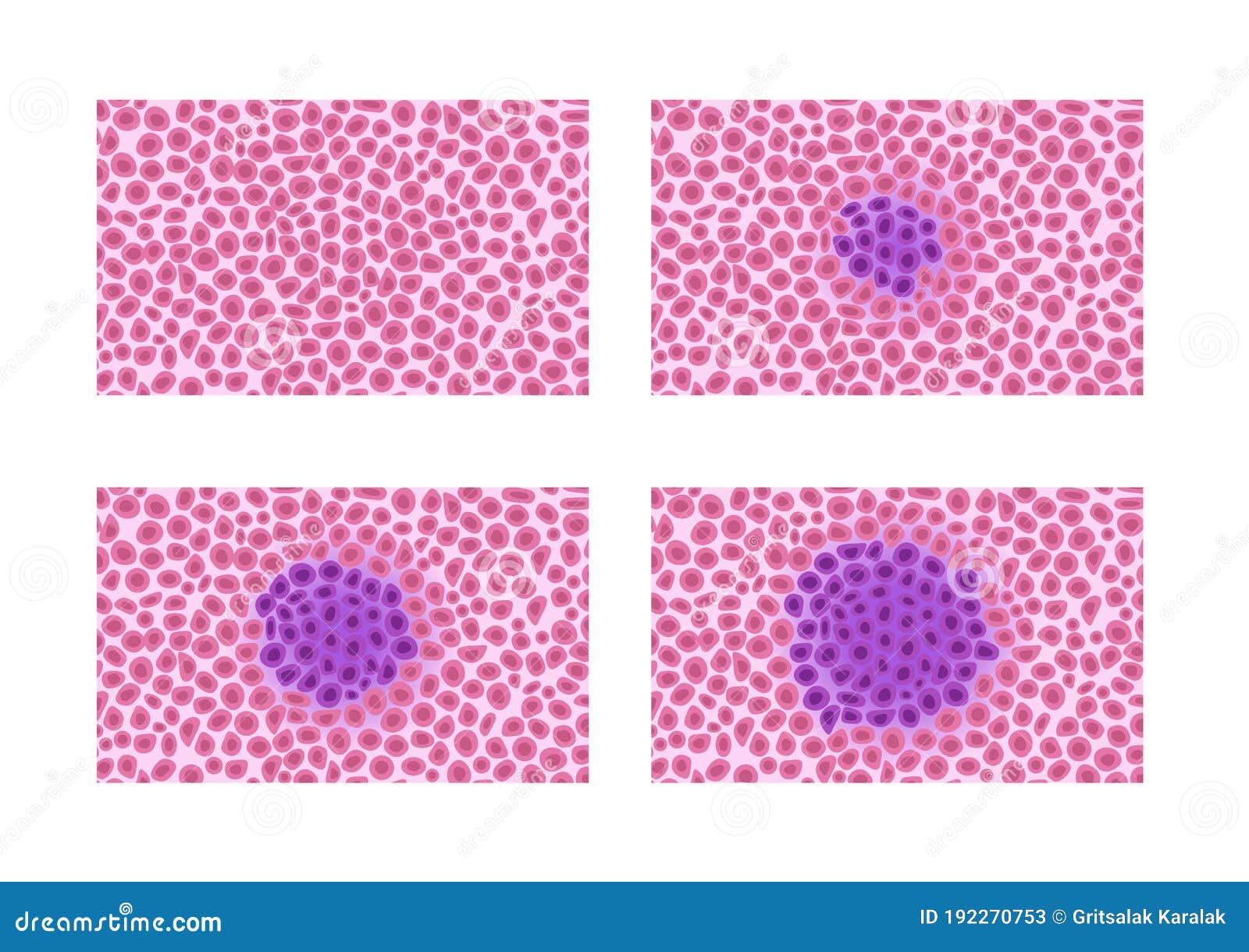 Cancer and Tumor Cell Stage and Development Vector. . Malignant Type ...