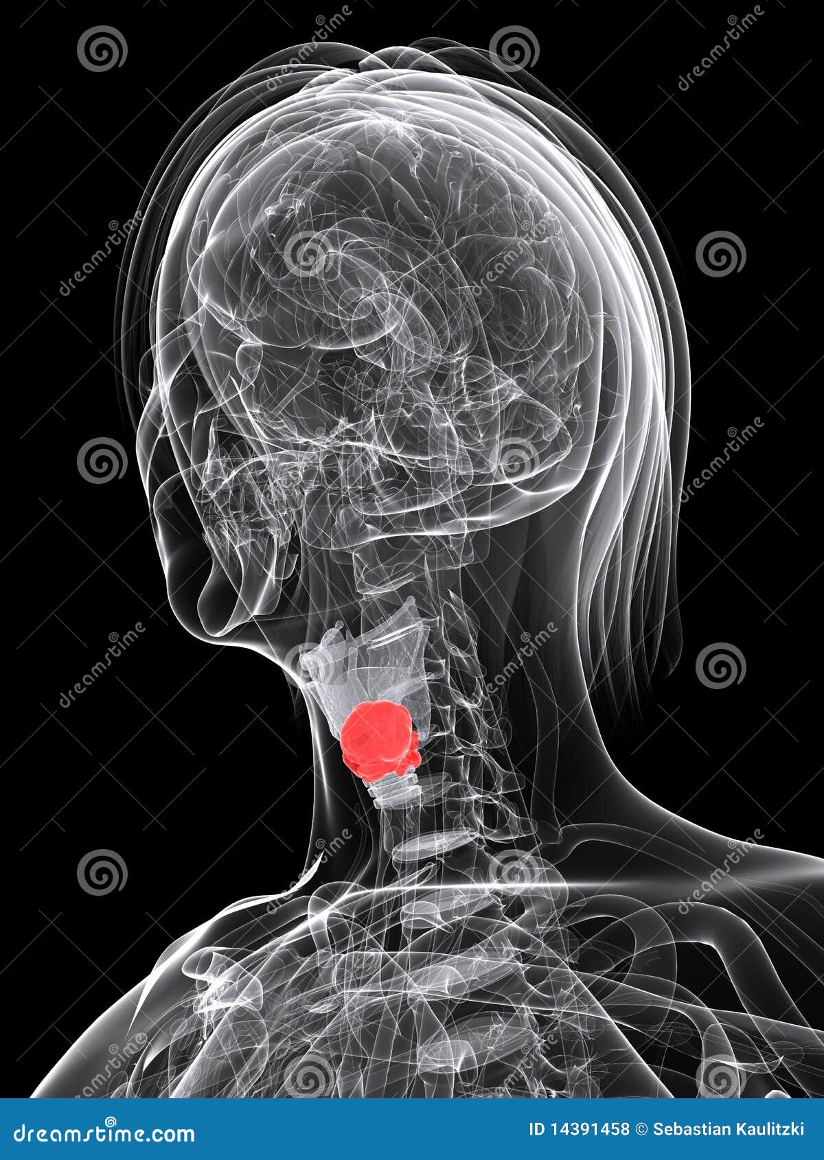 Cancro da laringe ilustração stock. Ilustração de glândula - 14391458