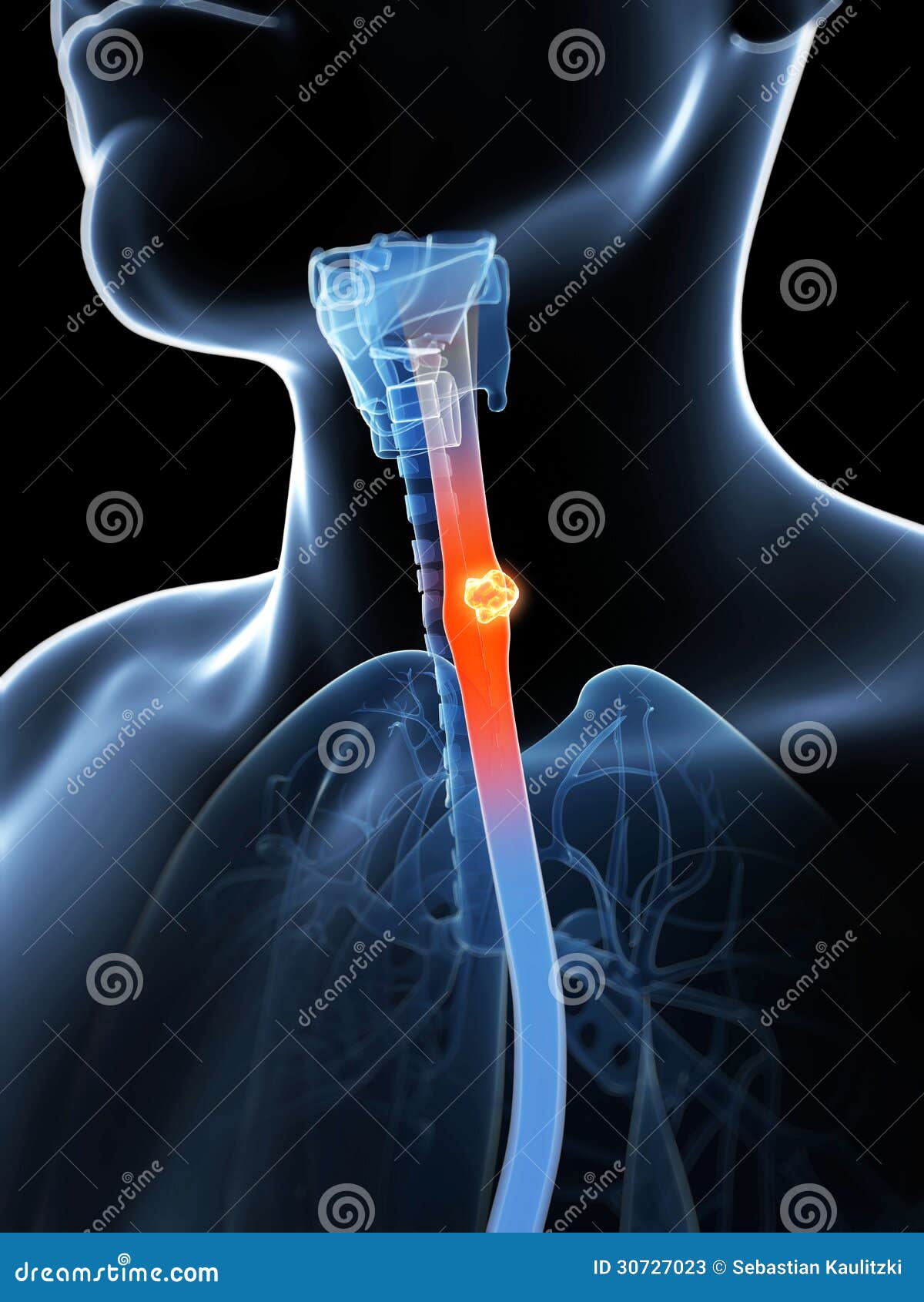 Cancro dell'esofago illustrazione di stock. Illustrazione di maschio ...