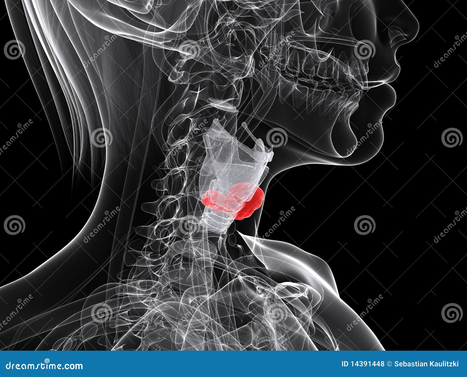 Cancro della laringe illustrazione di stock. Illustrazione di ...