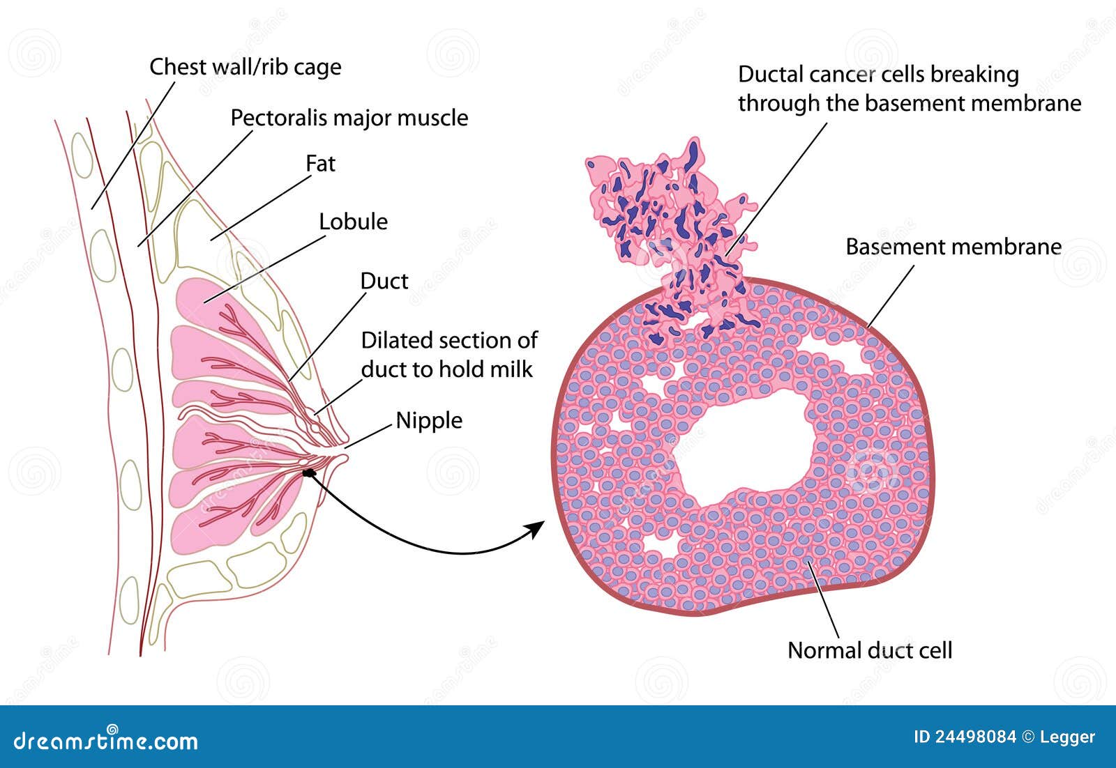 Quadrantectomia De Mama