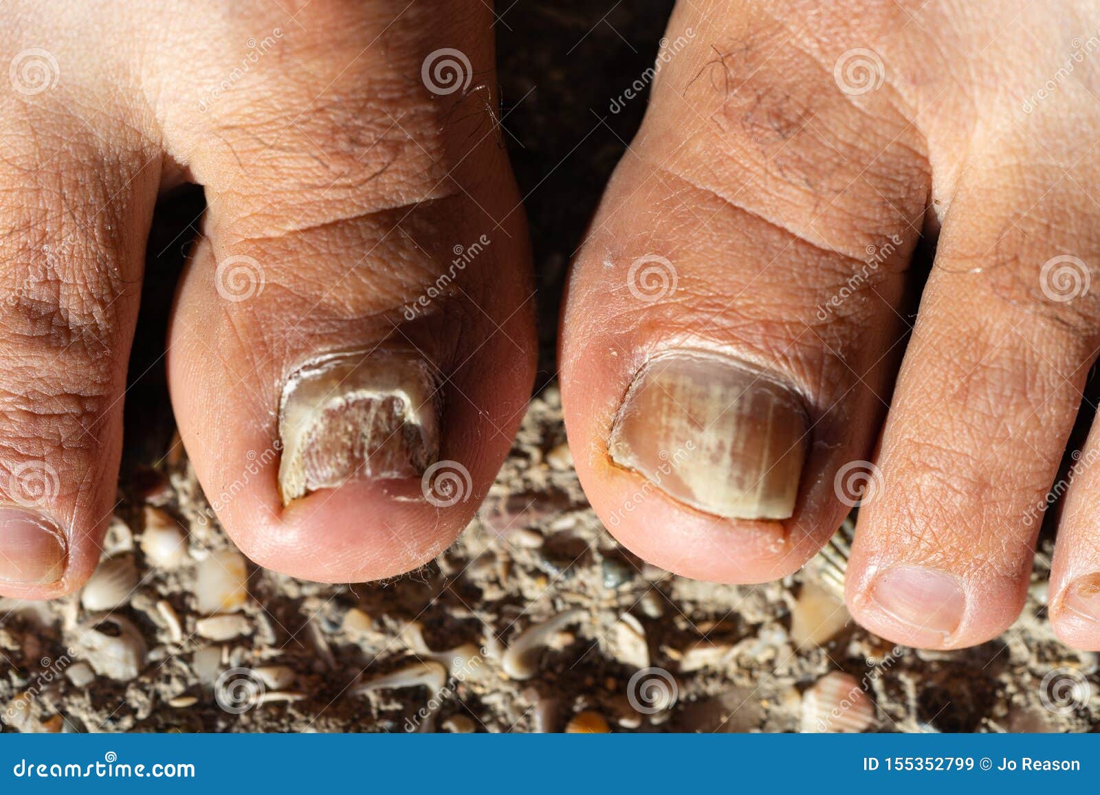 Candida Albicans toe nail stock image. Image of fungus - 155352799