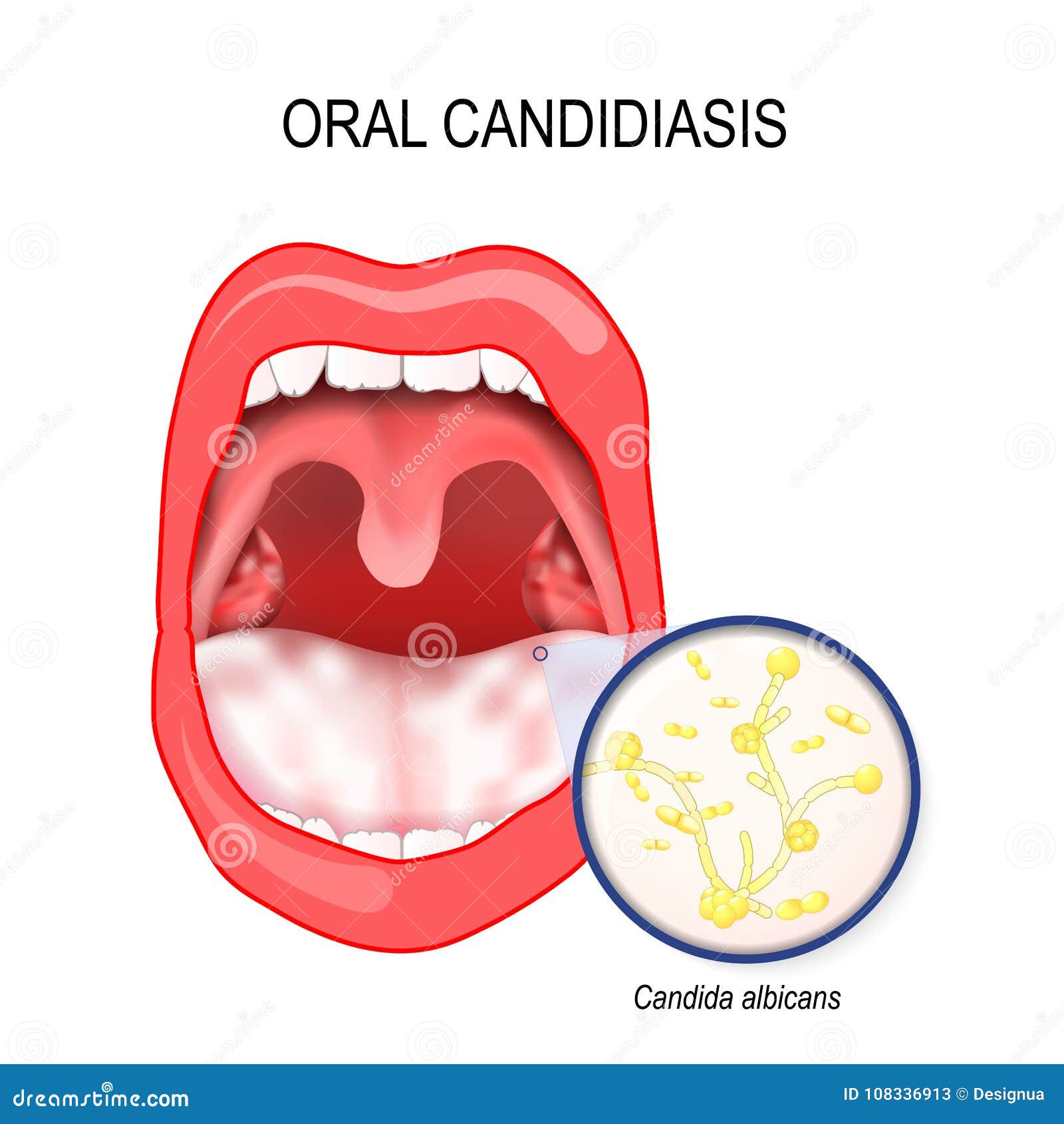 Candidiasis oral E ilustración del vector. Ilustración de hongos ...
