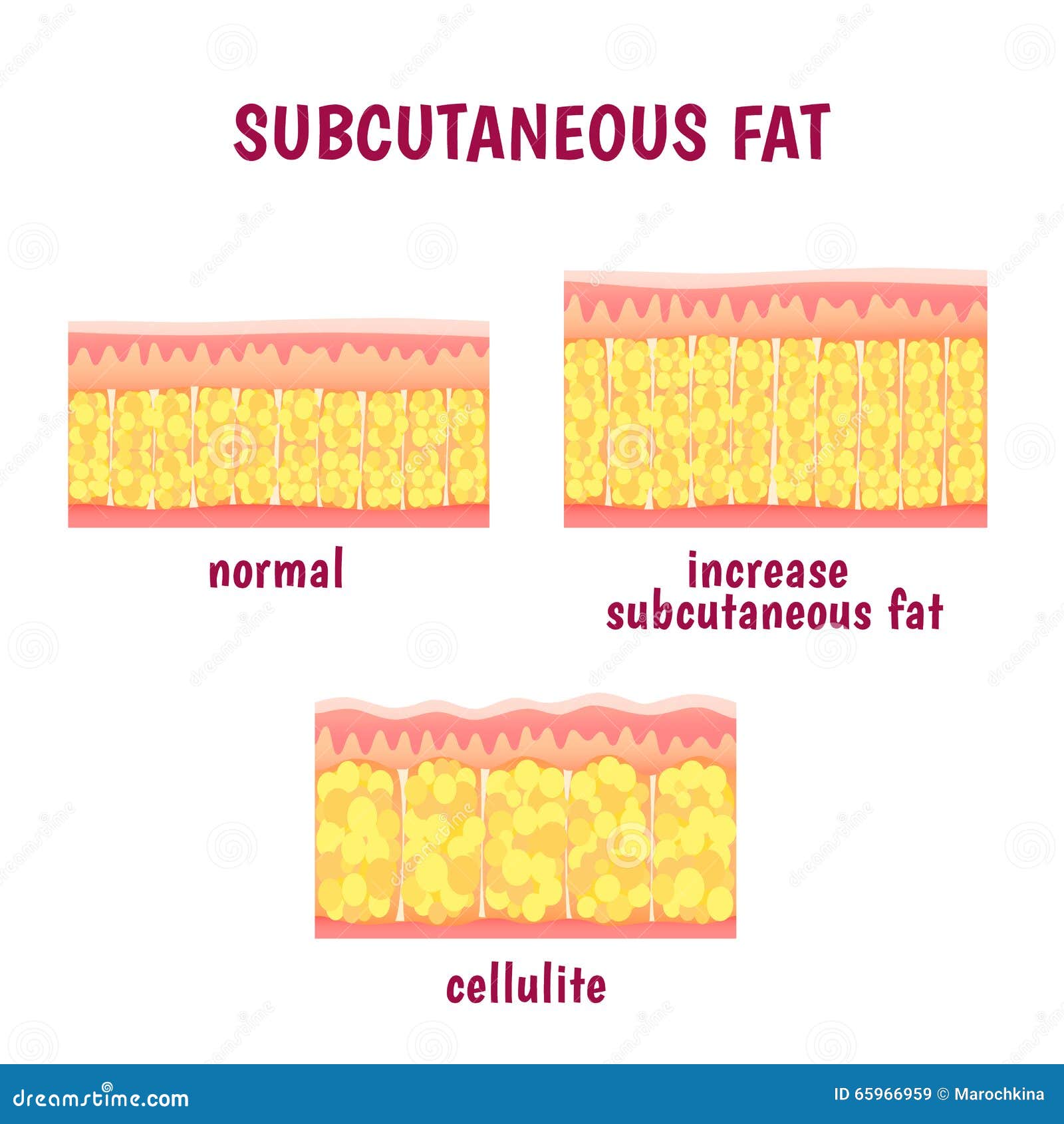 Capa Seccional De Cuero De Grasa Subcutánea Ilustración del Vector ...