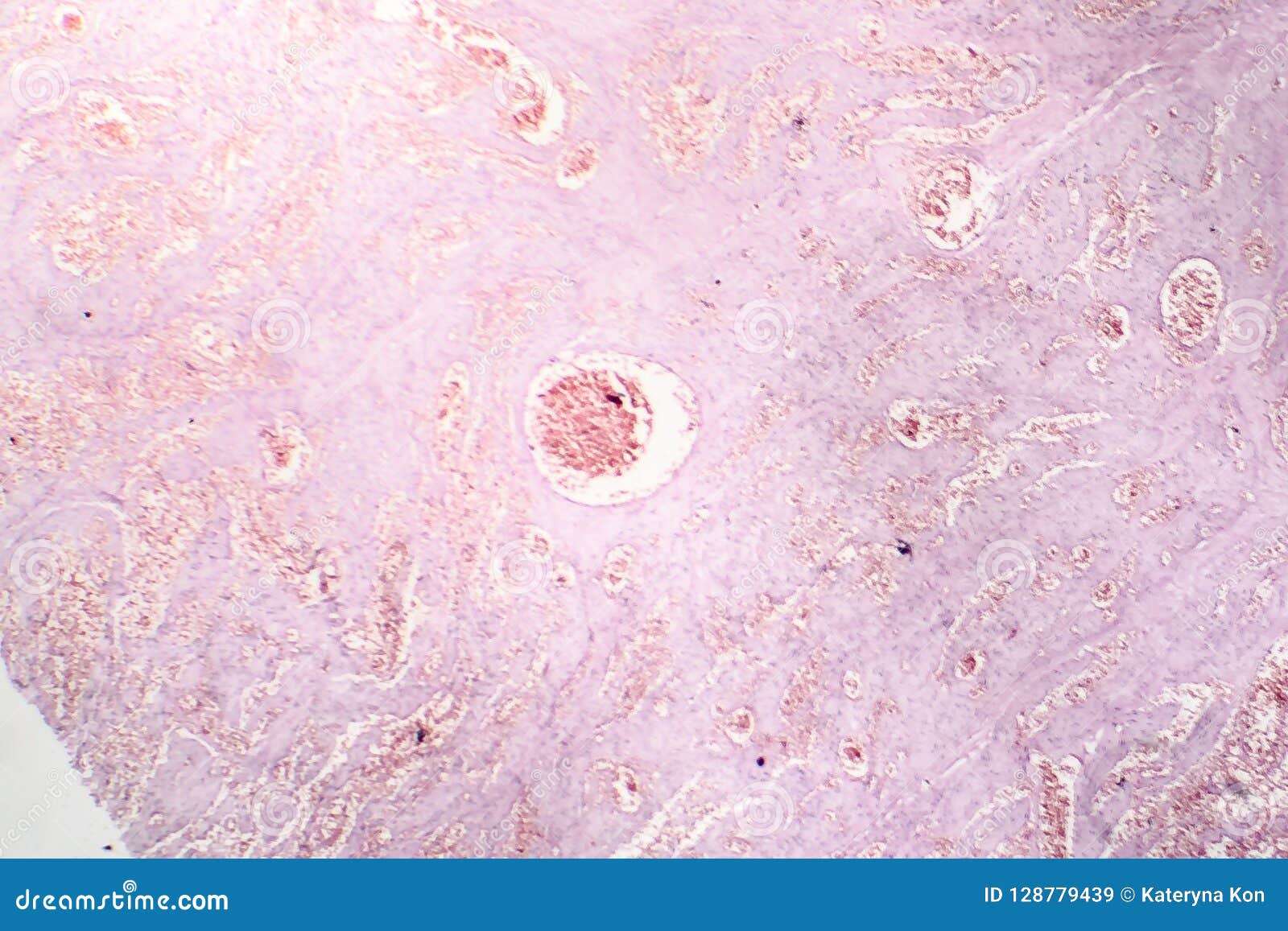 Capillary Hemangioma, Light Micrograph Stock Image - Image of histology ...