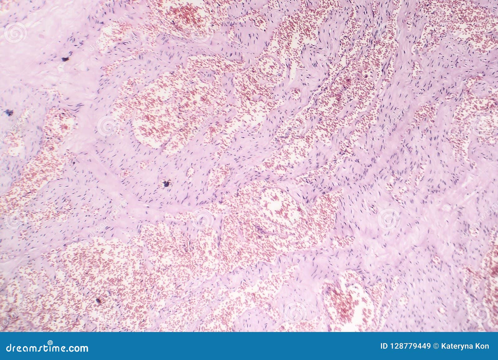 Capillary Hemangioma, Light Micrograph Stock Image - Image of ...