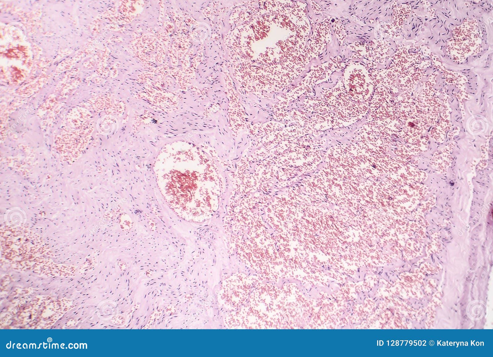 Capillary Hemangioma, Light Micrograph Stock Photo - Image of blood ...