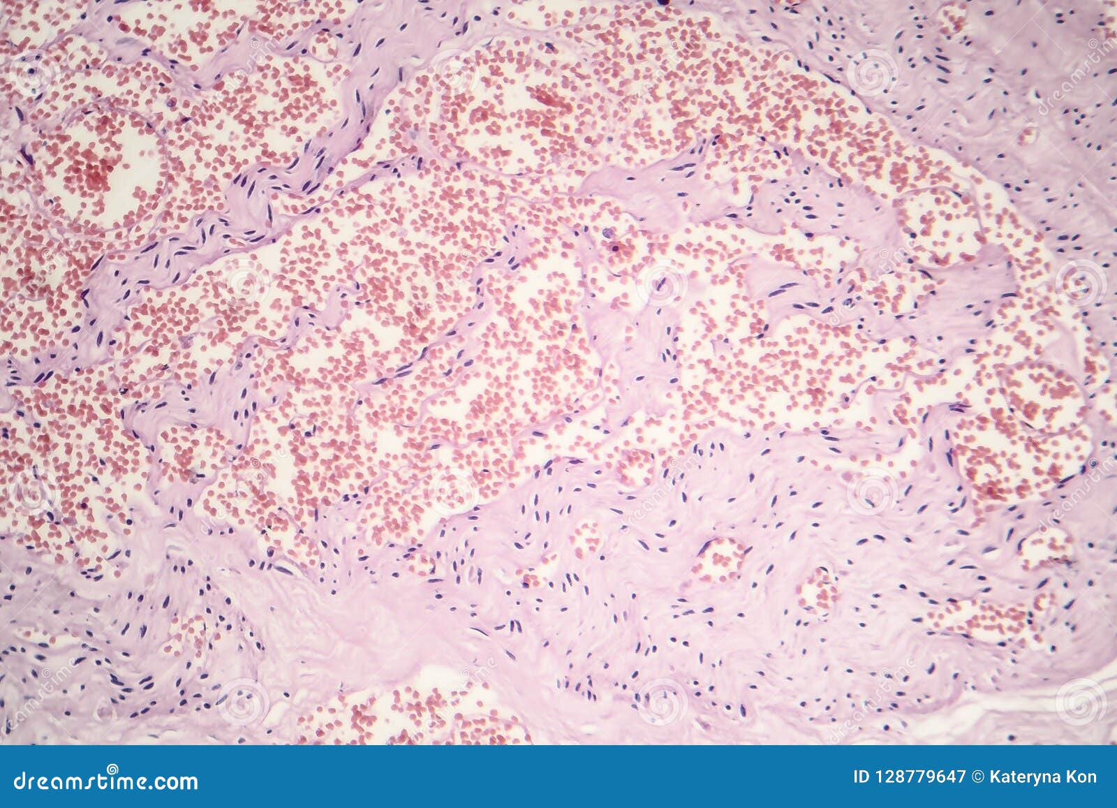 Capillary Hemangioma, Light Micrograph Stock Image - Image of ...