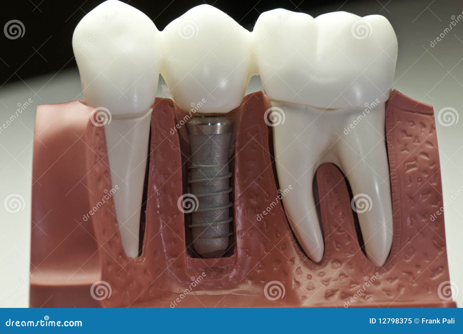 Capped Dental Implant Model Stock Image - Image of crown, roots: 12798375