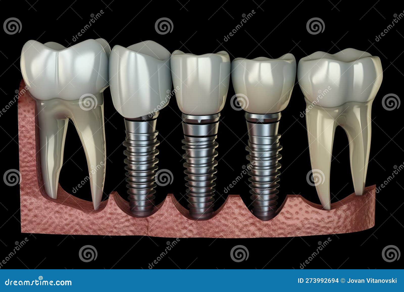 Capped Dental Implant Model Created by Generative AI Stock Illustration ...