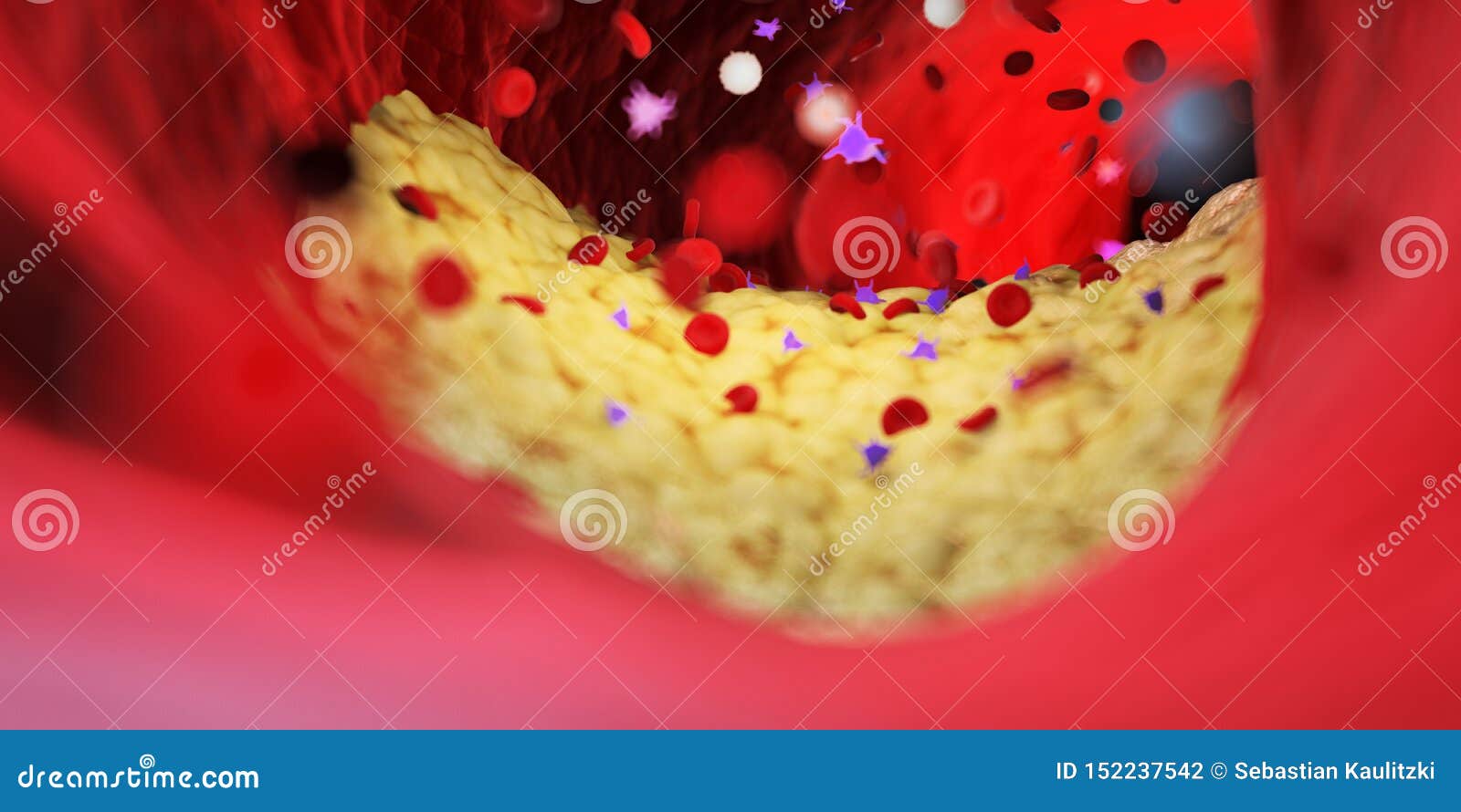 A capped plaque stock illustration. Illustration of flow - 152237542