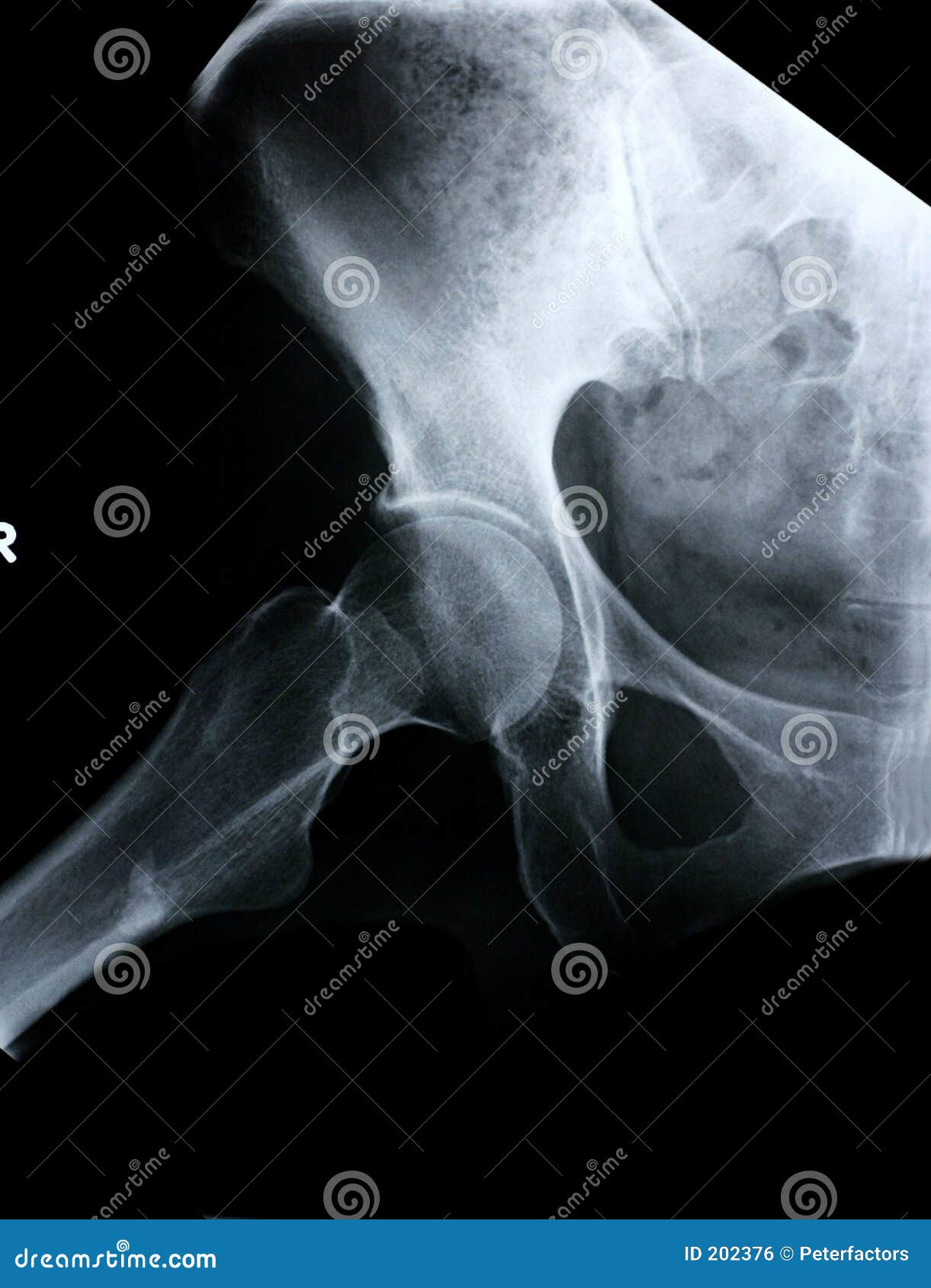 Cara De La Radiografía/de La Cadera Foto de archivo - Imagen de spine ...