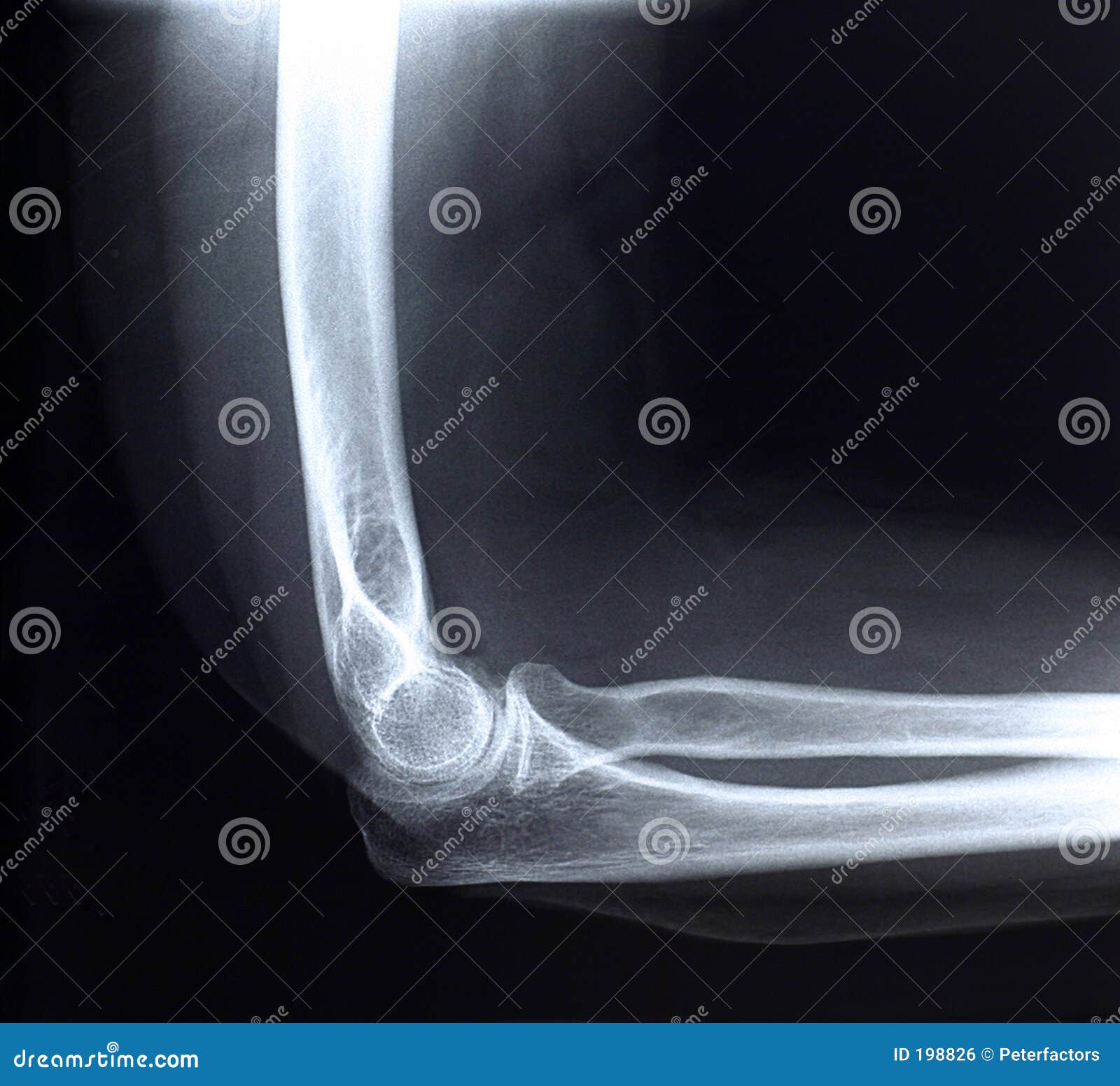 Cara De La Radiografía/del Codo Foto de archivo - Imagen de cirujano ...