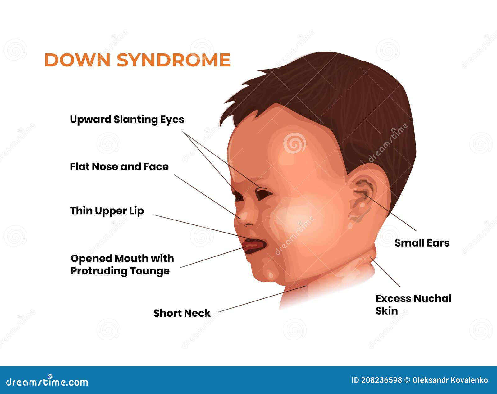 Caracteristicas Del Sindrome De Down