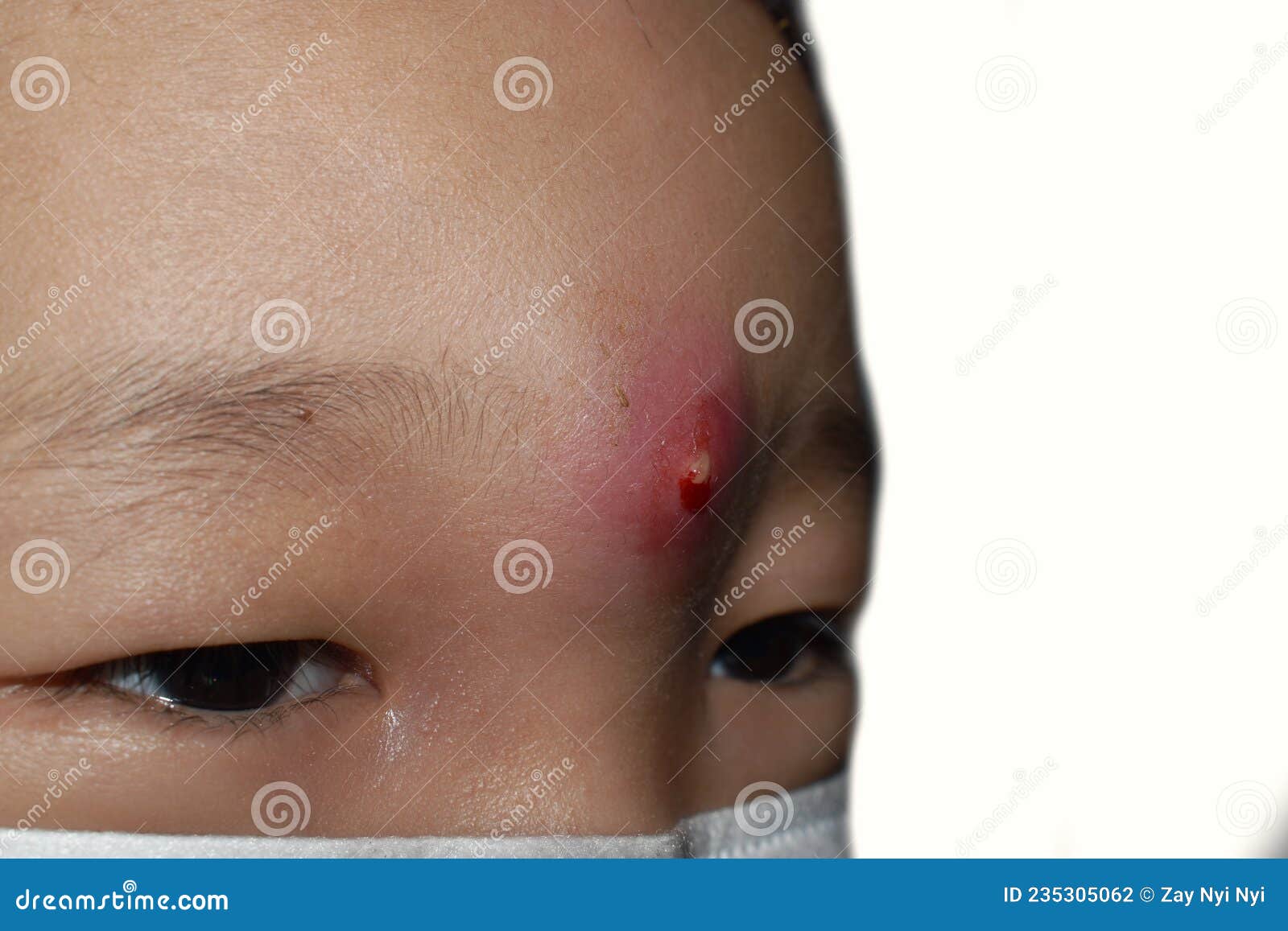 Carbuncle or Abscess at Forehead Stock Photo - Image of face, bacterial ...