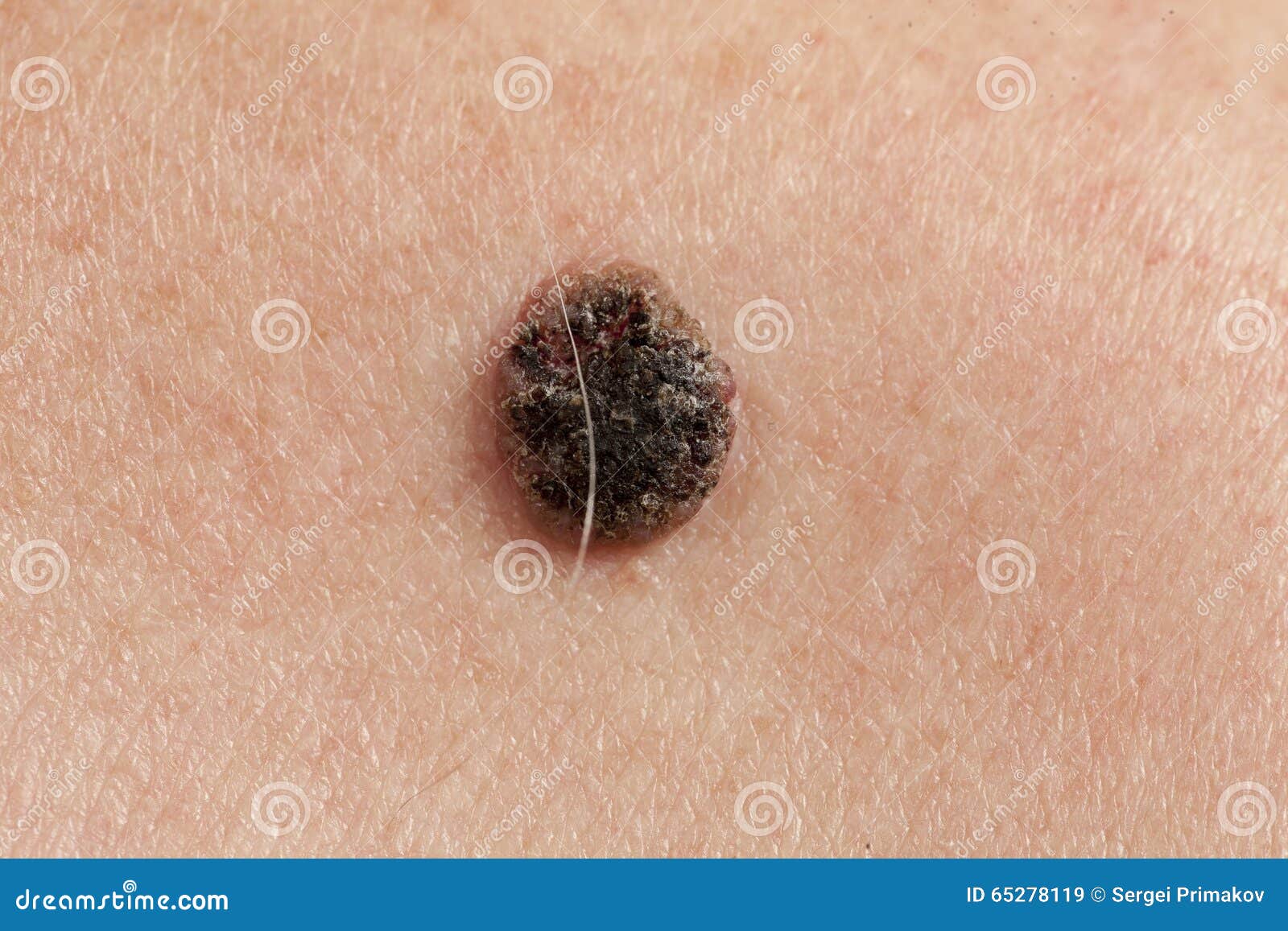 Carcinoma De Células Escamosas De Keratinizing De La Piel Imagen De