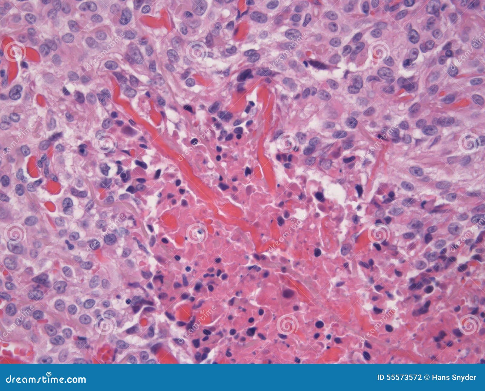 Carcinoma Delle Cellule Basali Fotografia Stock - Immagine di macchiato ...