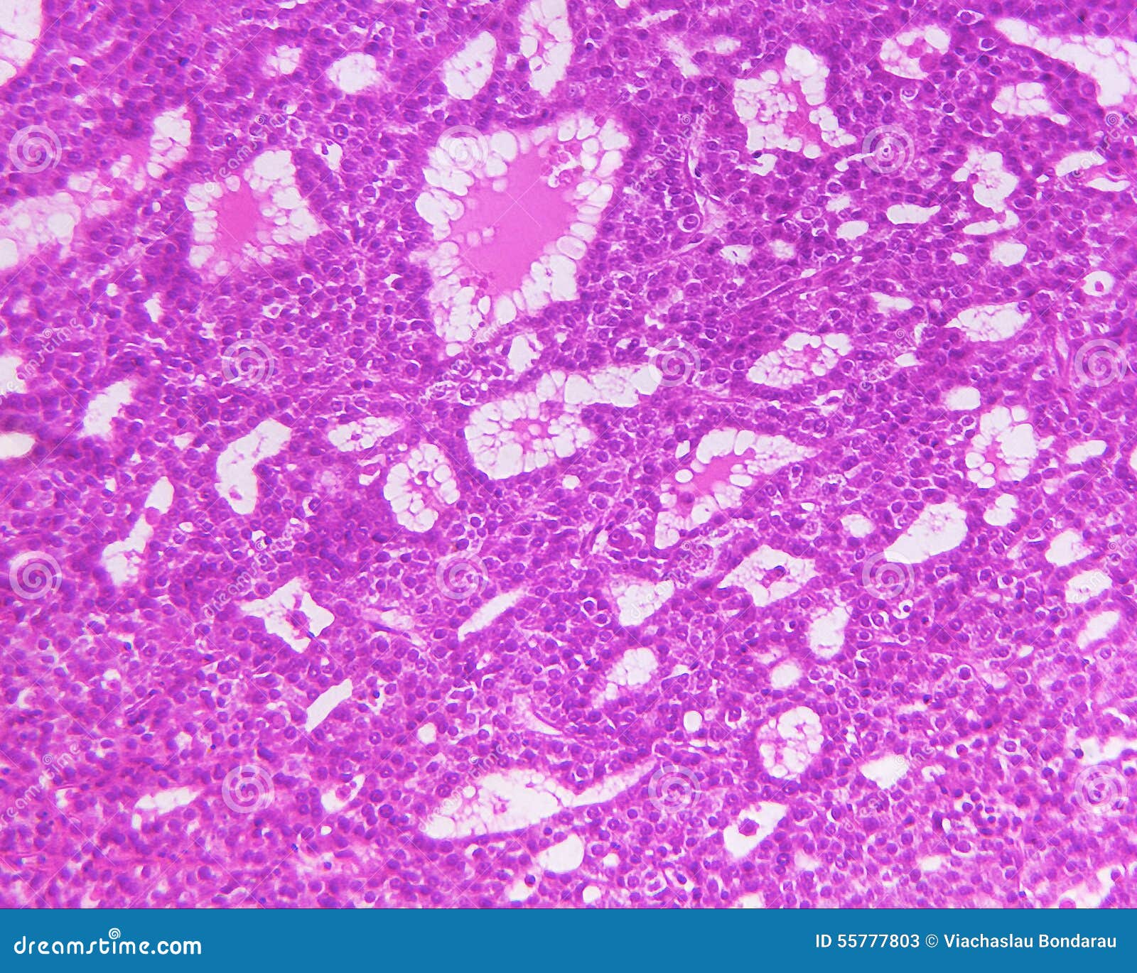 Carcinoma Hepatocelular De Un Ser Humano Imagen de archivo - Imagen de ...