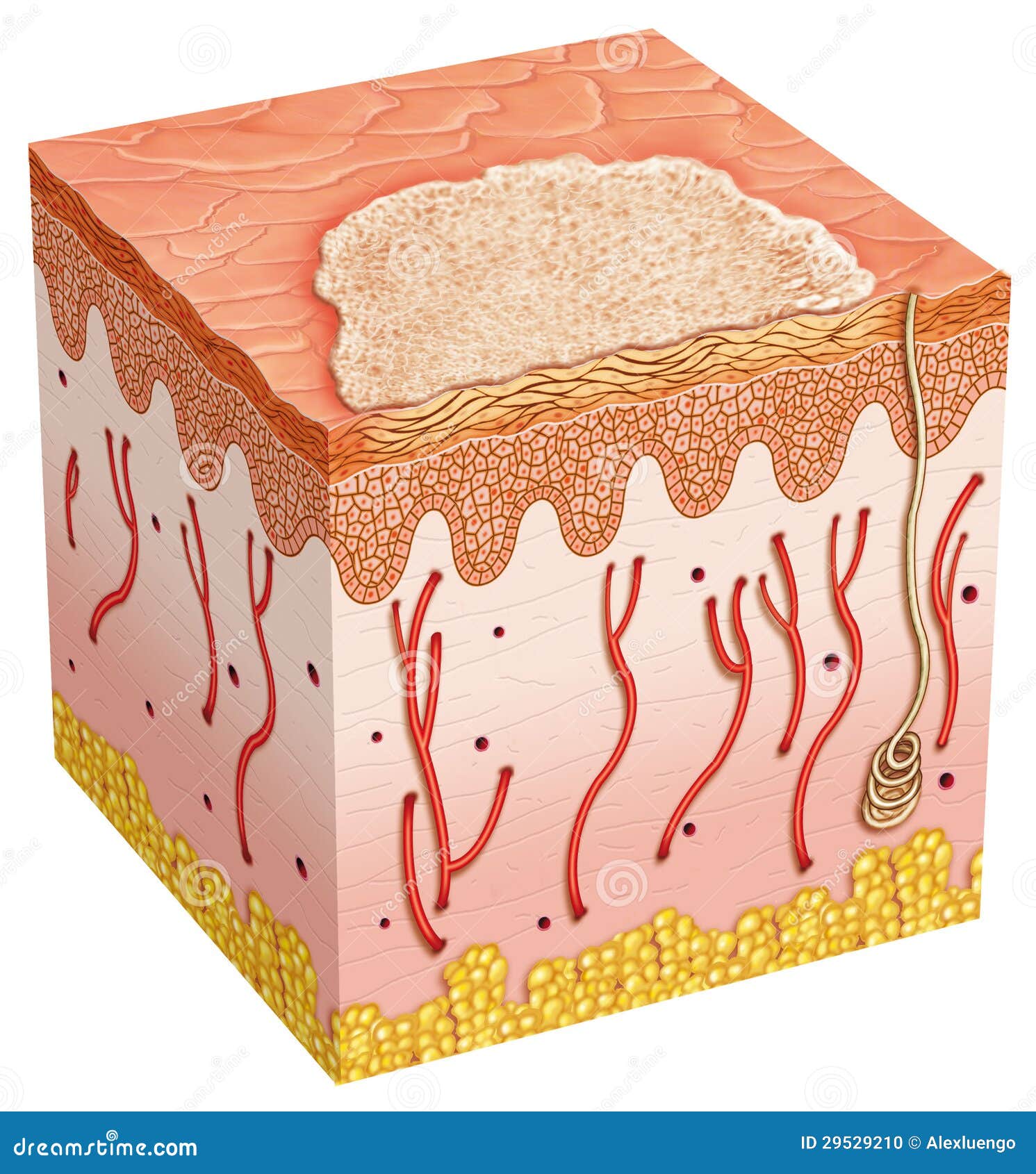 Carcinome De Cellule Basale Illustration Stock - Illustration du ...