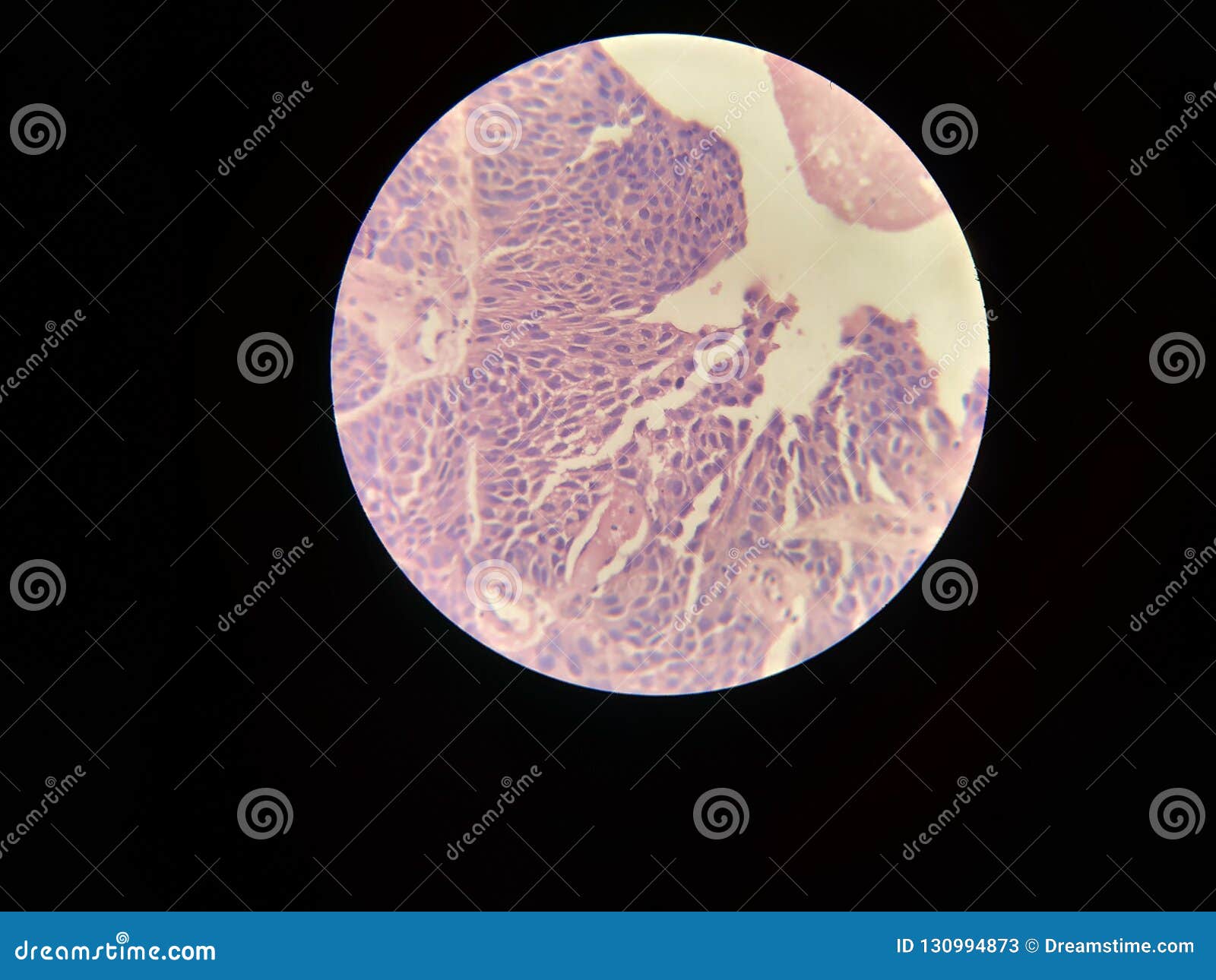 Carcinome Transitoire De Cellules D'Urothelial Image stock - Image du ...