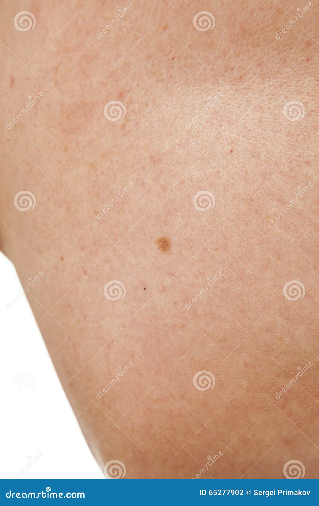 Carcinoom Van De Keratinizings Het Squamous Cel Van De Huid Stock Foto ...