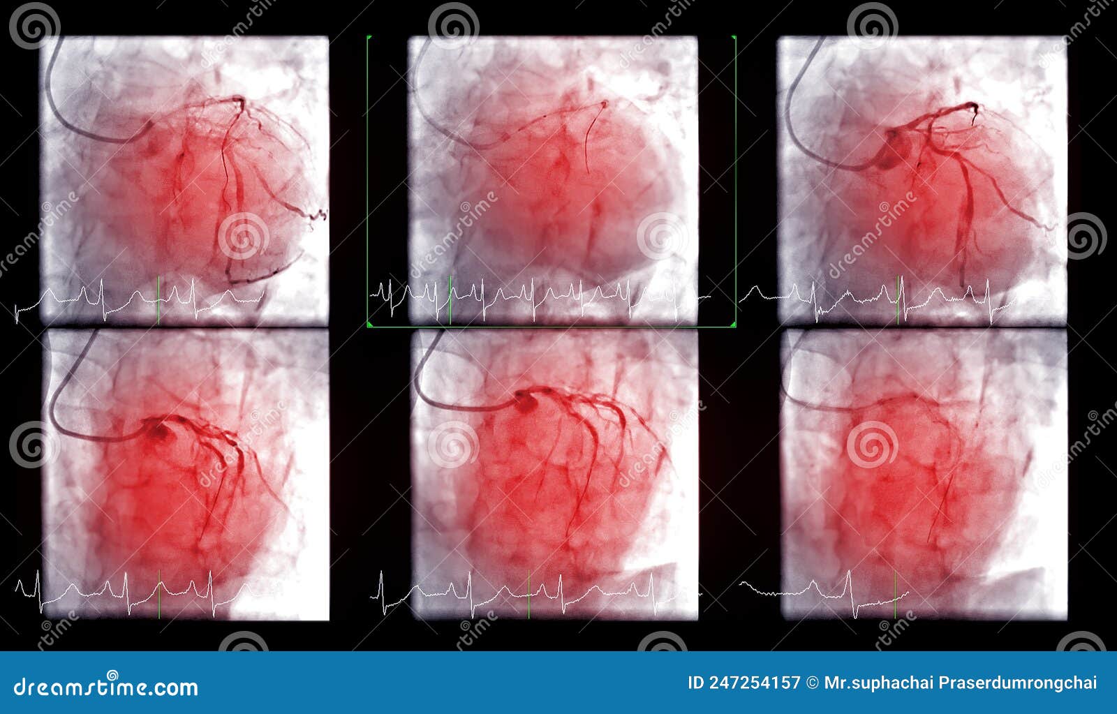 Cardiac Catheterization is a Test Used To Find Out Cardiac Arrest Stock ...