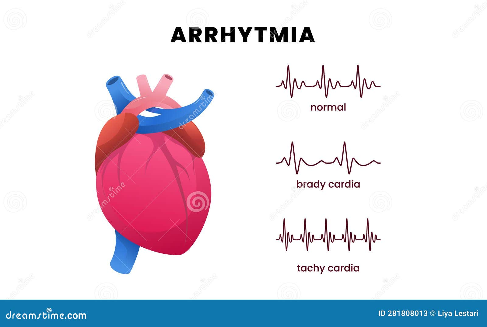 Cardiac Disease Arrhythmia With A Heart And Pulse Ecg Showcasing