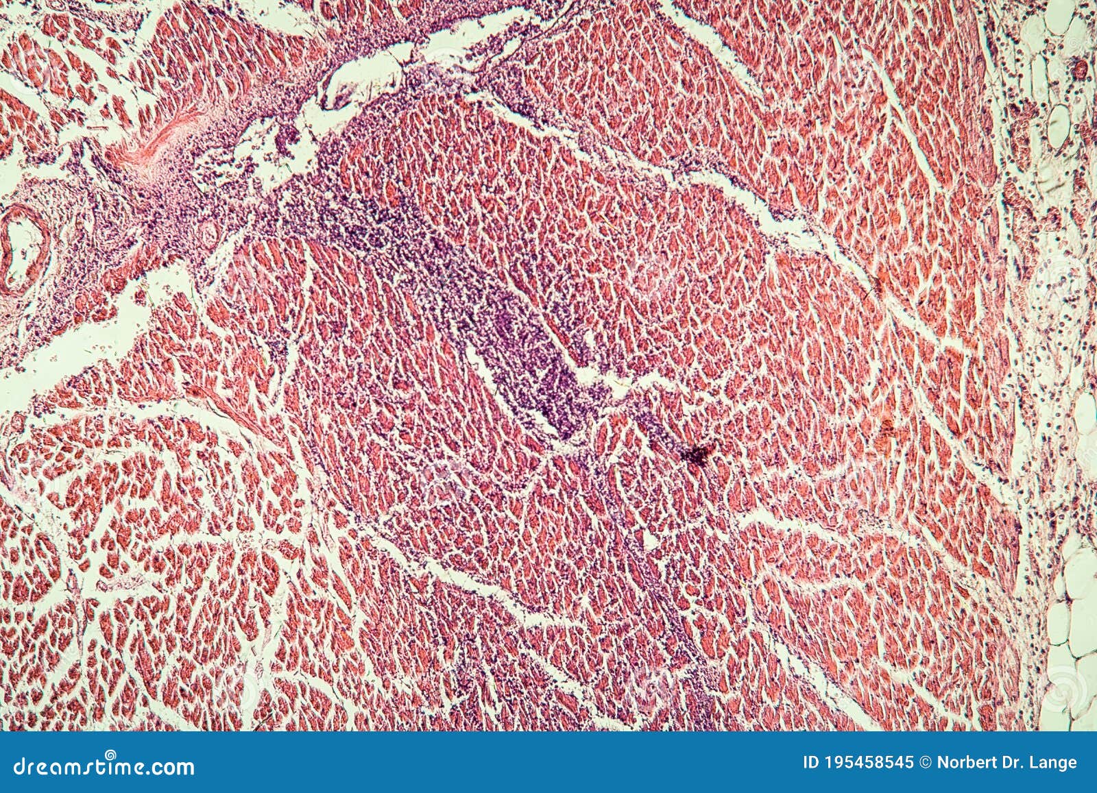 Cardiac Muscle after Infarction, Tissue Section Stock Image - Image of ...