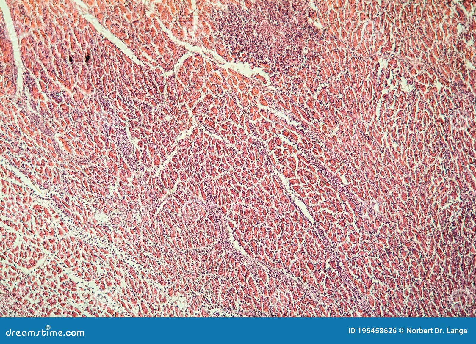 Cardiac Muscle after Infarction, Tissue Section Stock Photo - Image of ...